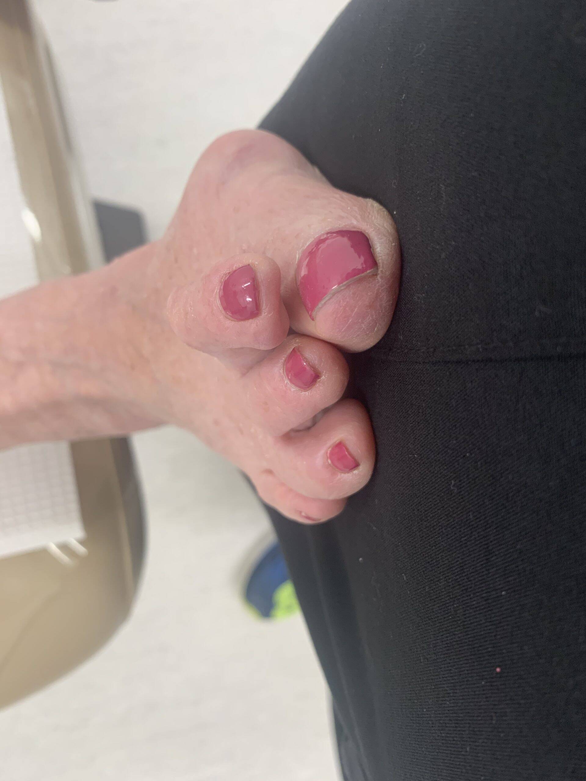 Hammertoe Before and After Photos | Northwest Surgery Center