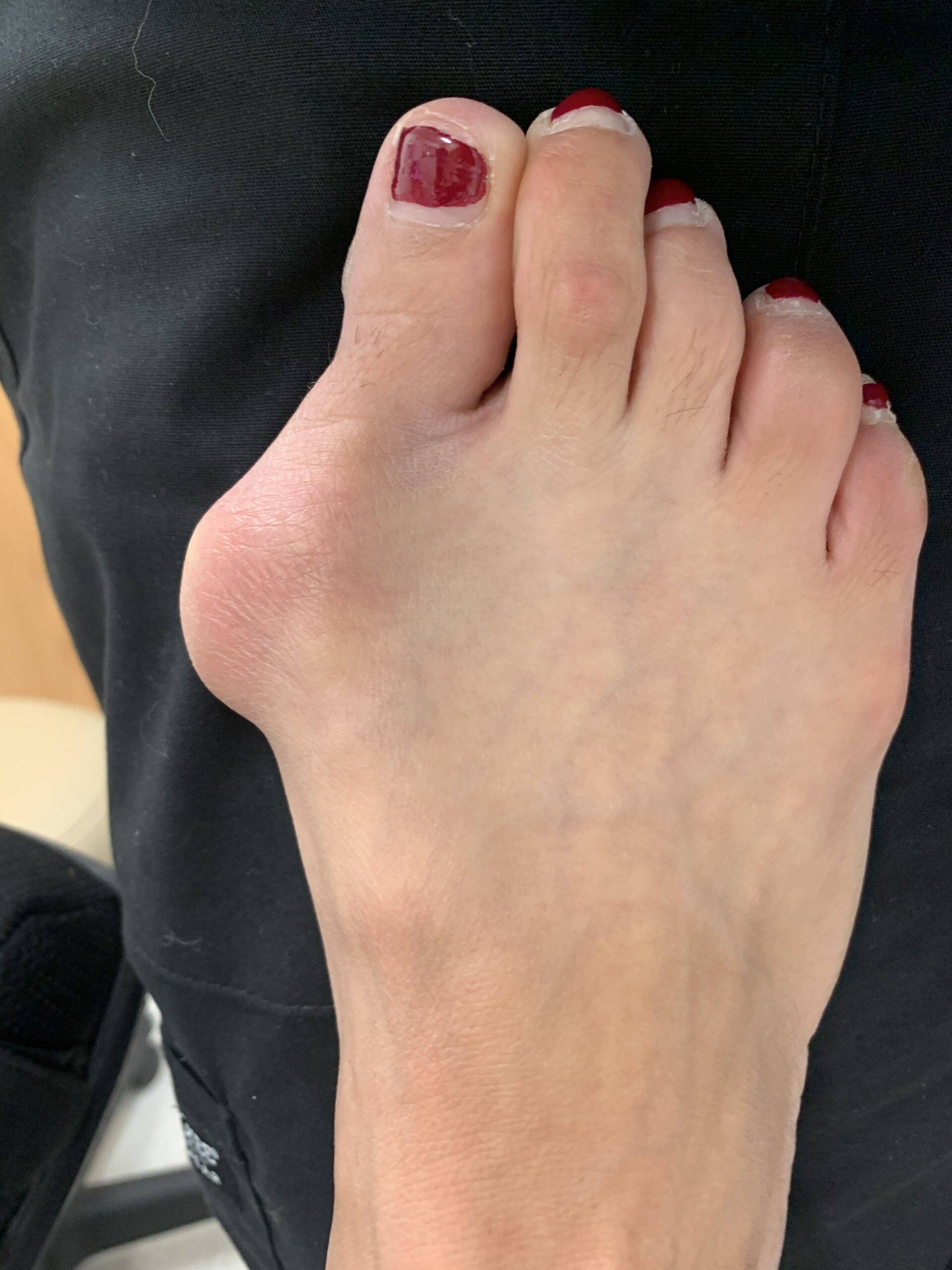Severe Bunion Before and After Photos | Northwest Surgery Center