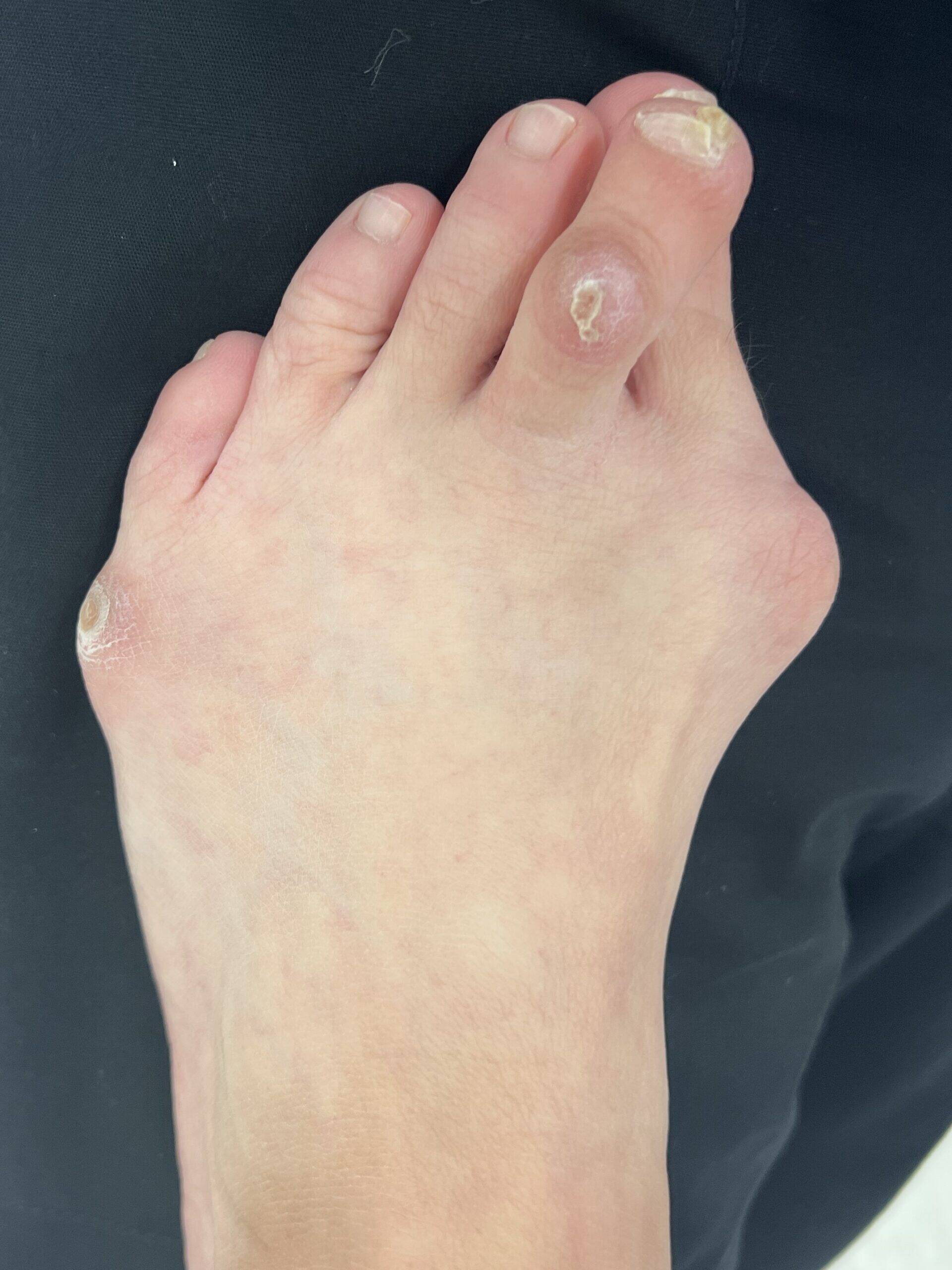 Severe Bunion Before and After Photos | Northwest Surgery Center