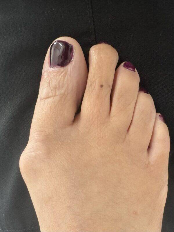 Mallet Toe Before and After Photos | Northwest Surgery Center