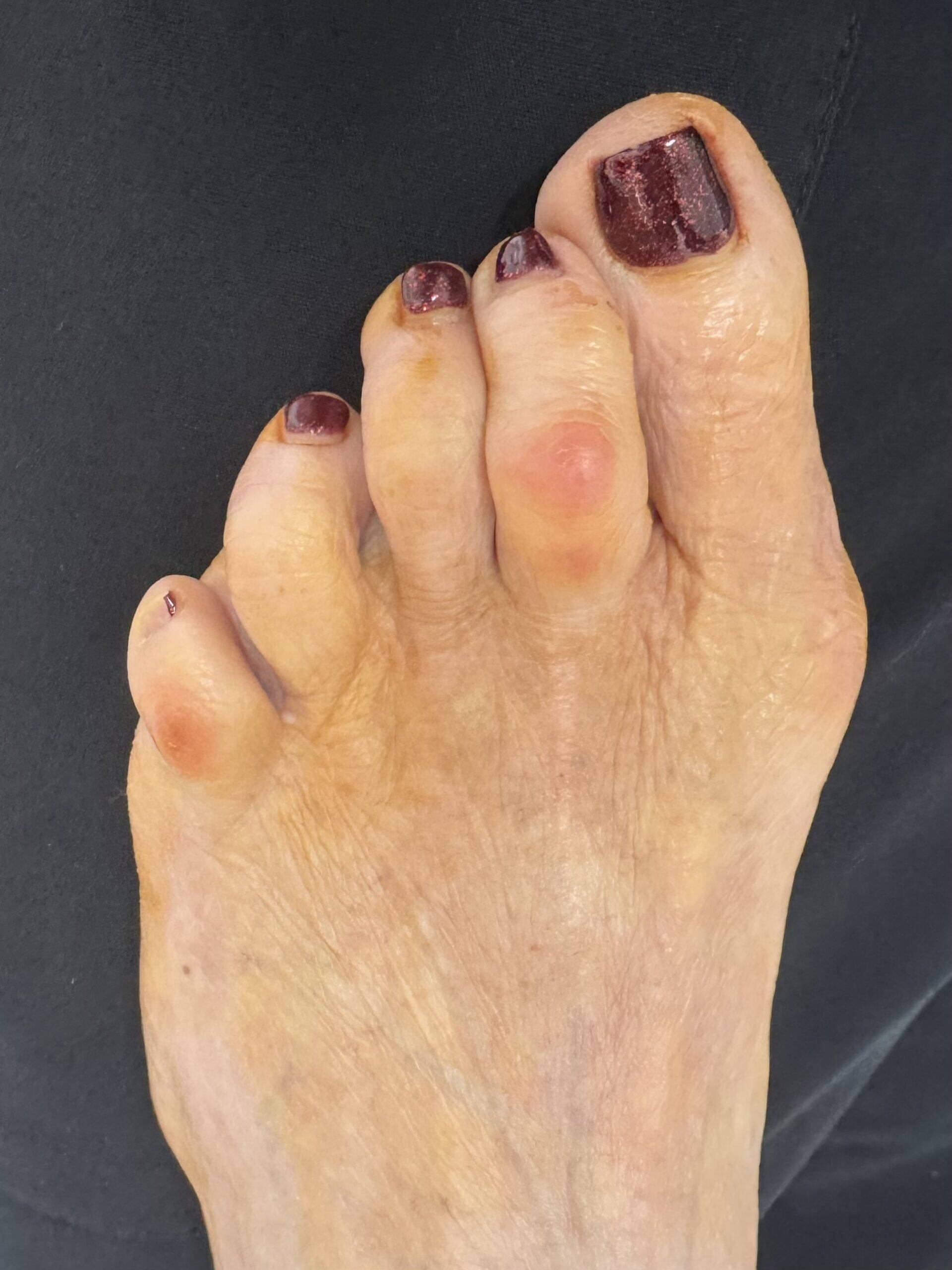 Hammertoe Before and After Photos | Northwest Surgery Center