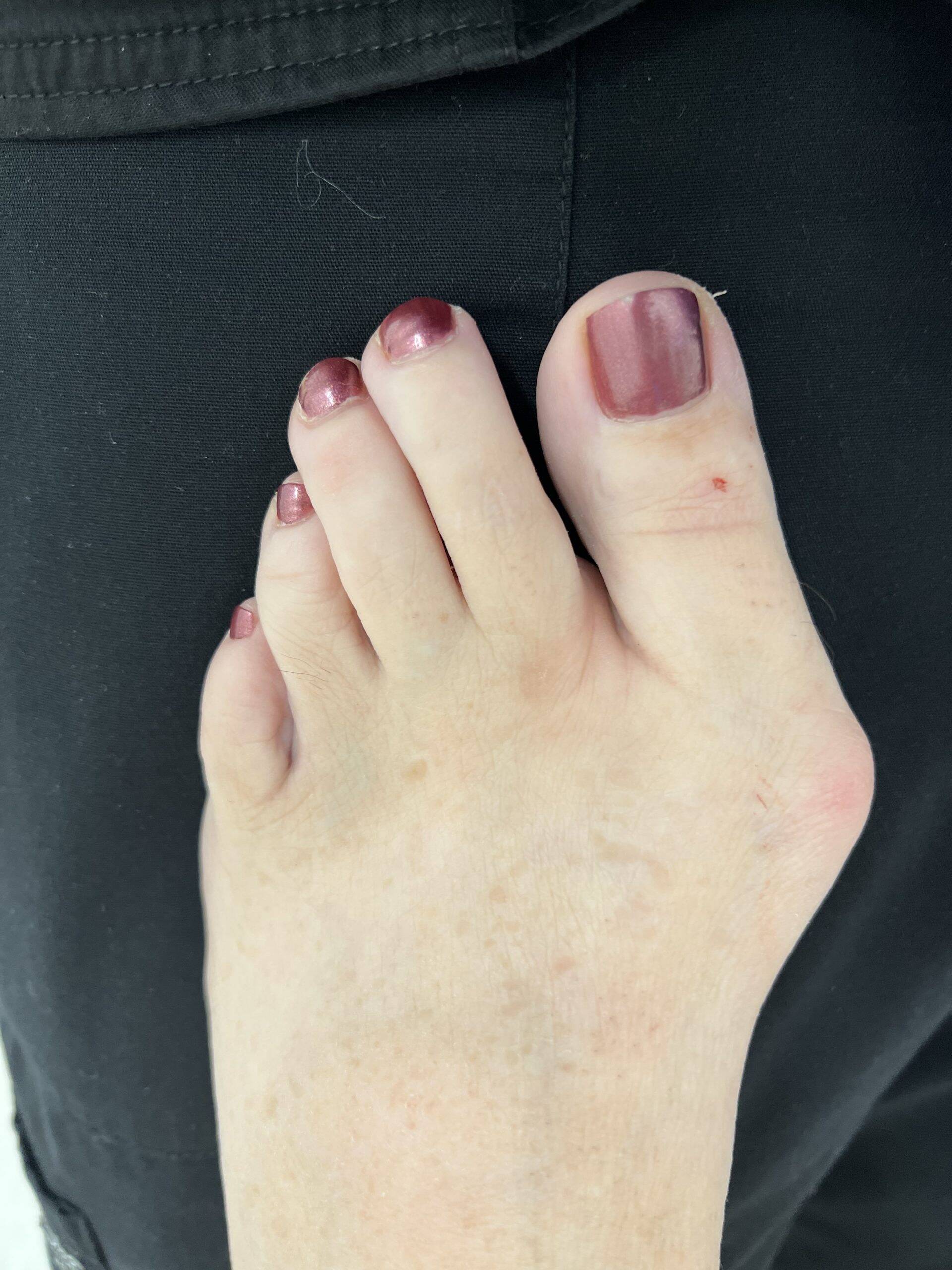 Severe Bunion Before and After Photos | Northwest Surgery Center