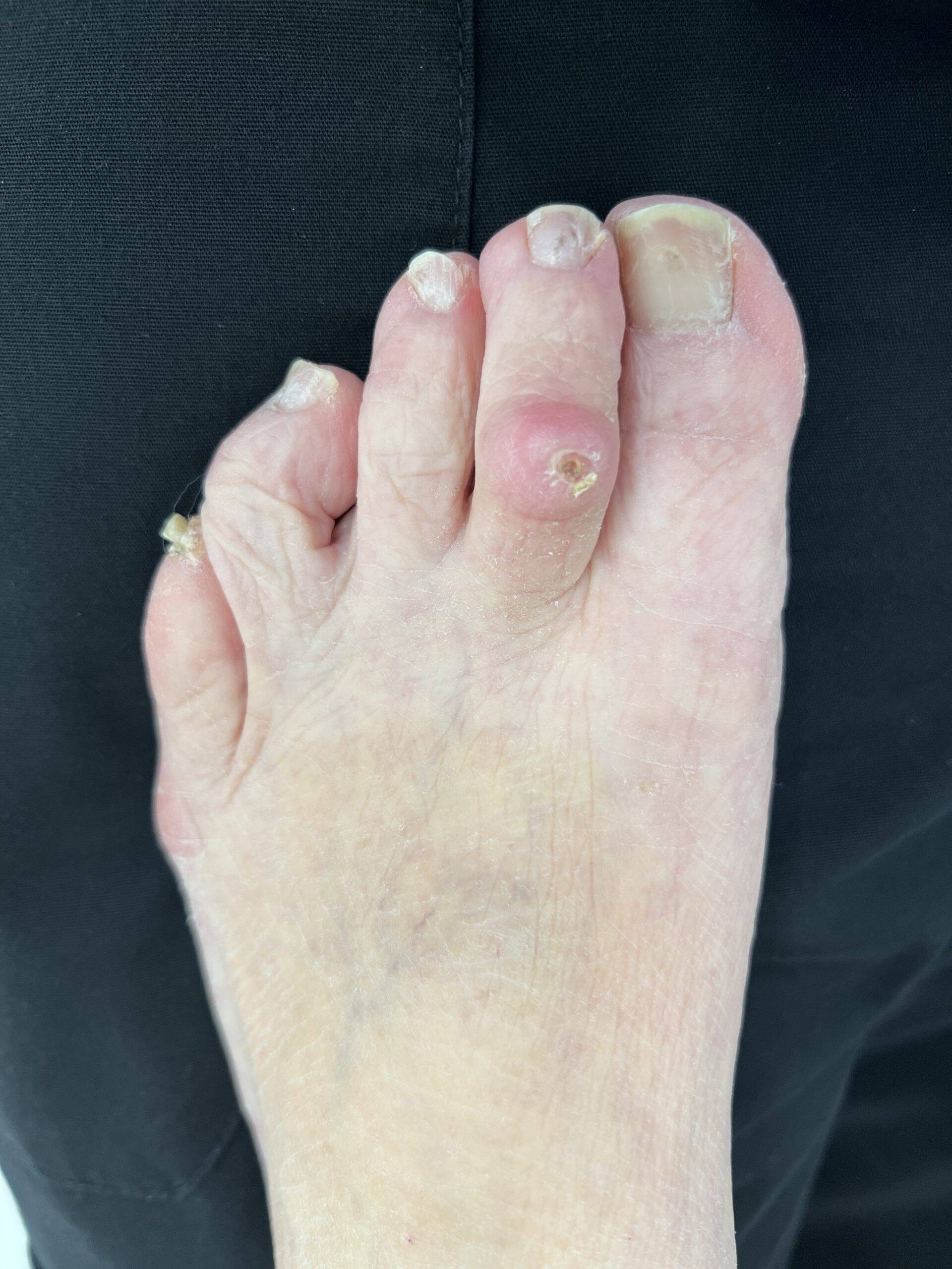 Hammertoe Before and After Photos | Northwest Surgery Center