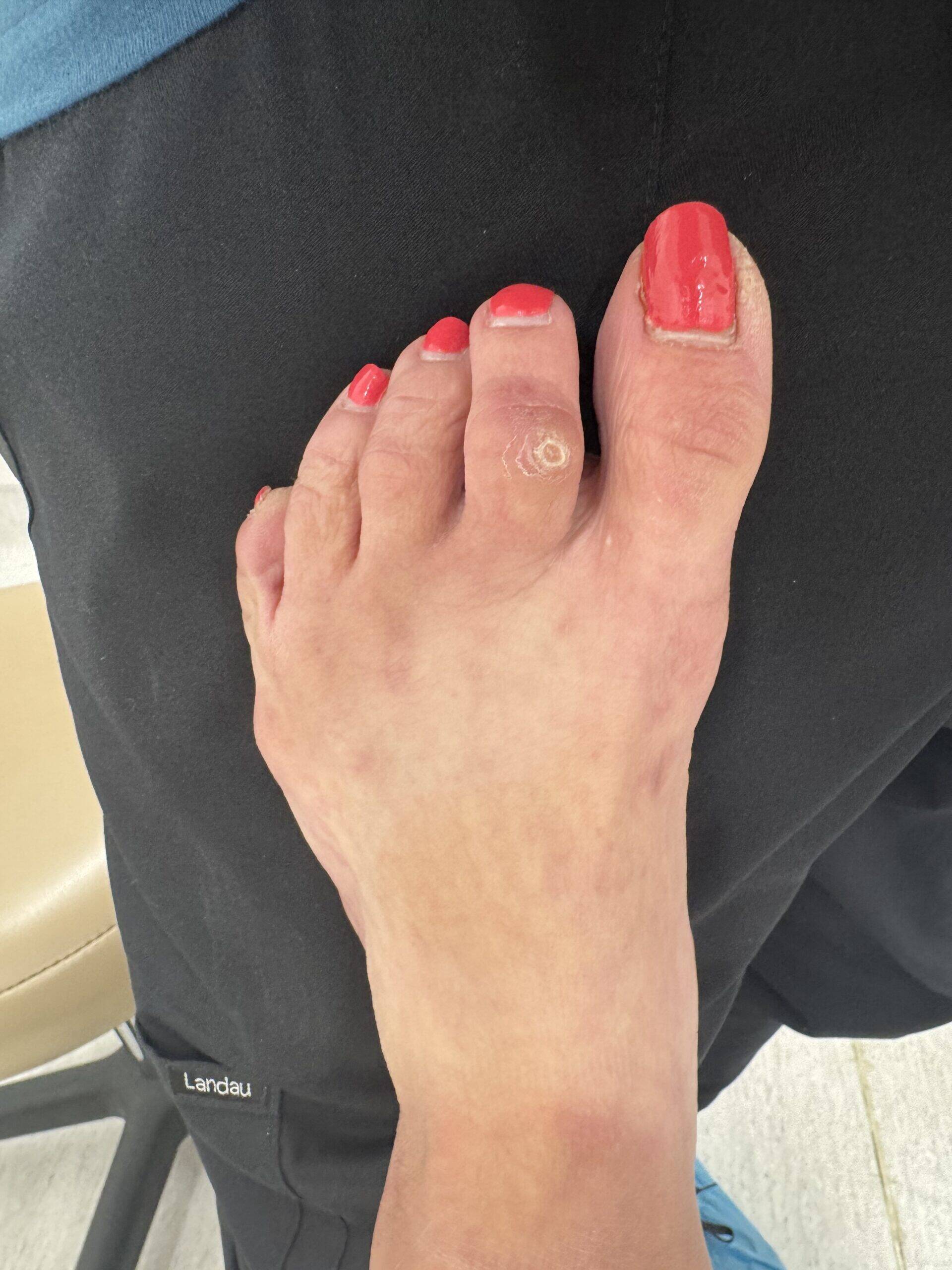 Severe Bunion Before and After Photos | Northwest Surgery Center