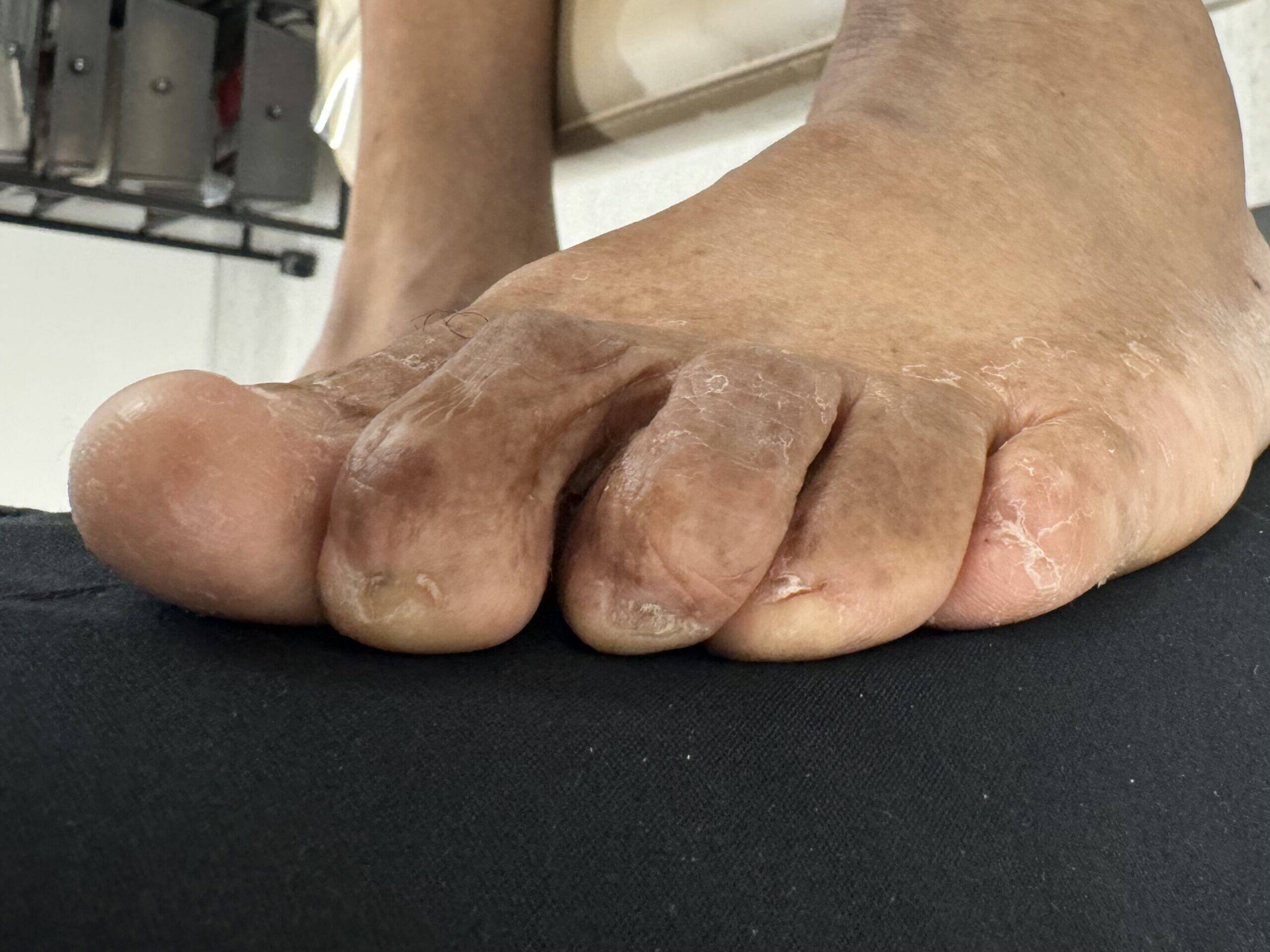 Hammertoe Before and After Photos | Northwest Surgery Center