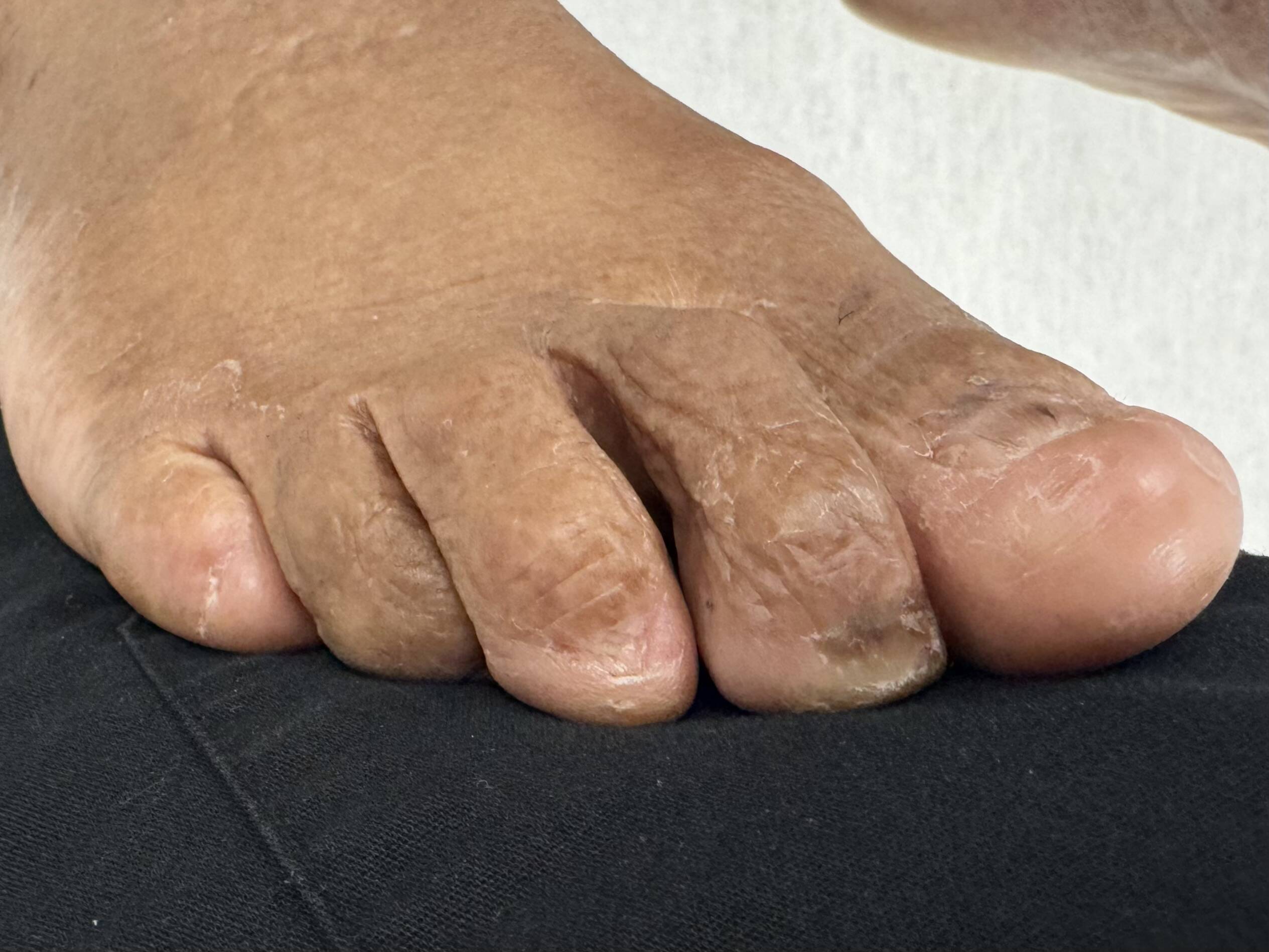 Hammertoe Before and After Photos | Northwest Surgery Center