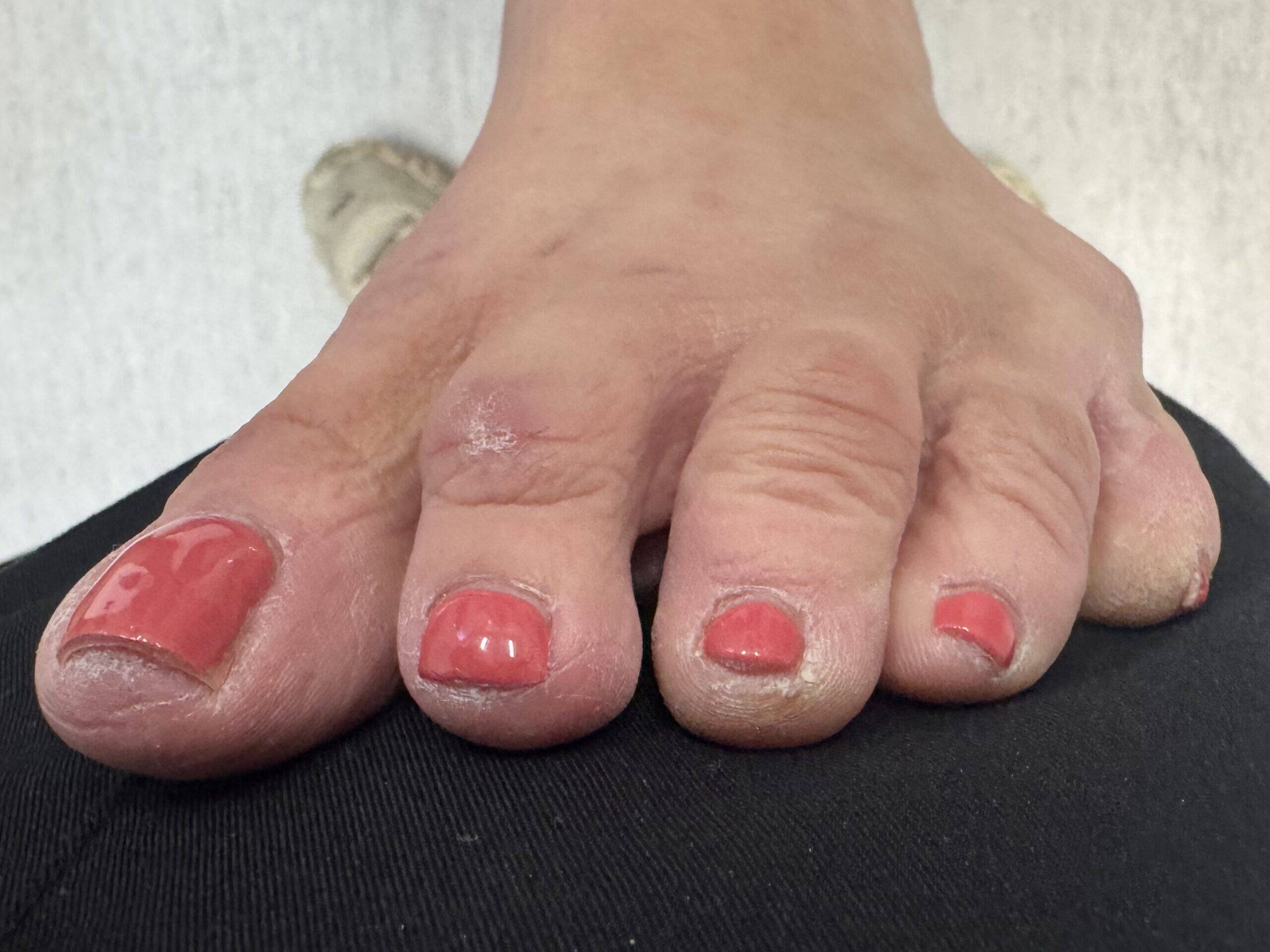 Severe Bunion Before and After Photos | Northwest Surgery Center
