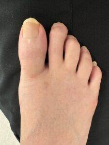 Bunion Before and After Photos | Northwest Surgery Center