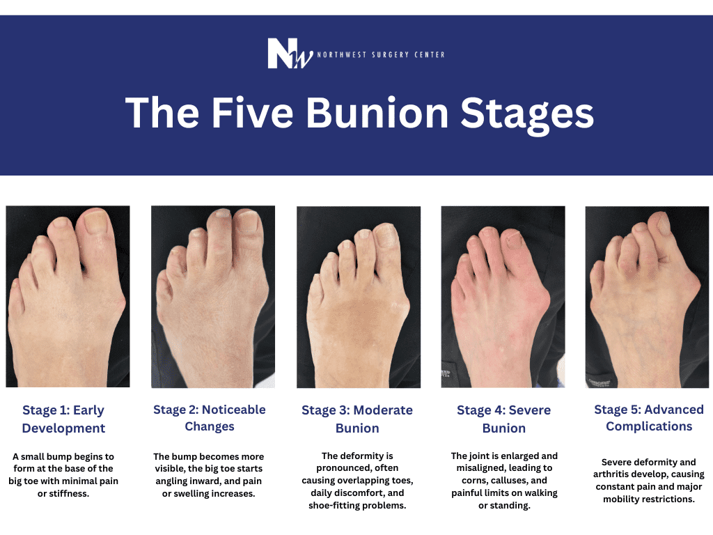 Understanding the 5 Bunion Stages and When to Seek Treatment