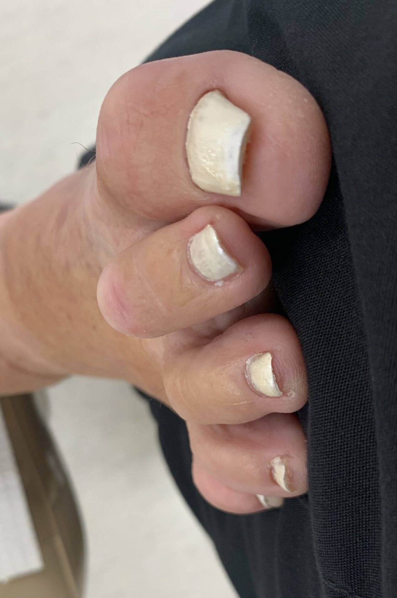 Hammertoe Before and After Photos | Northwest Surgery Center