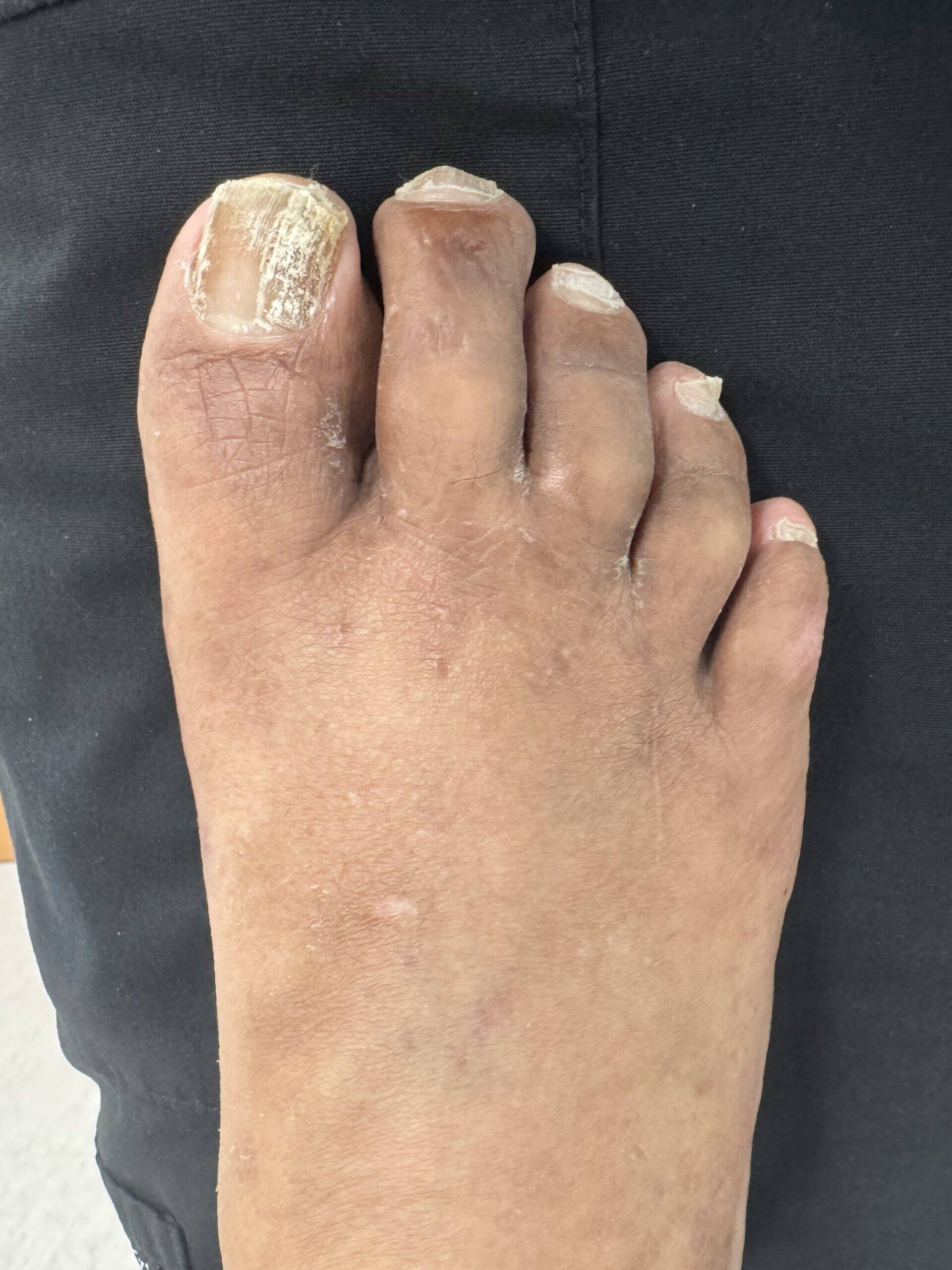 Hammertoe Before and After Photos | Northwest Surgery Center