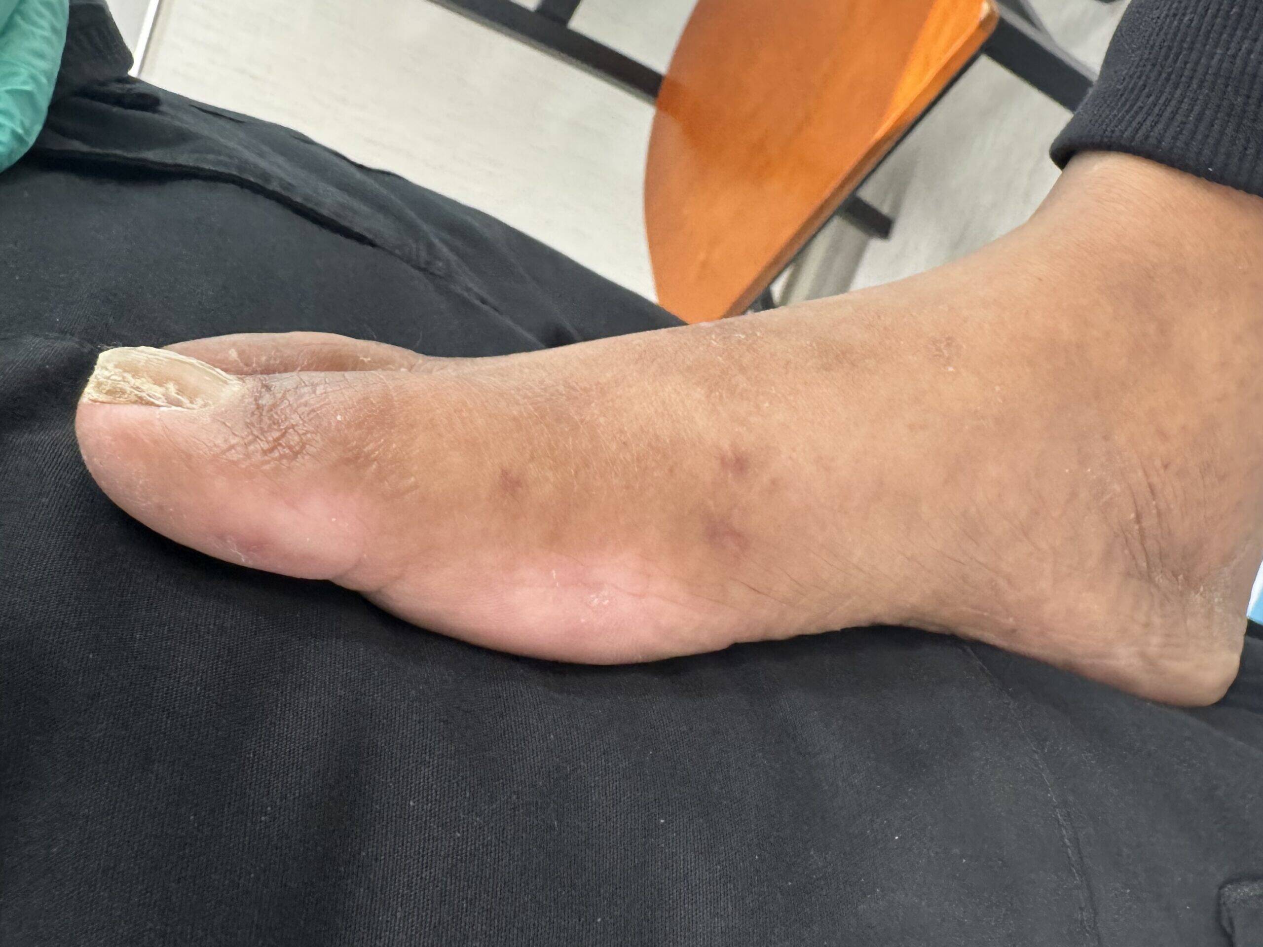 Hammertoe Before and After Photos | Northwest Surgery Center