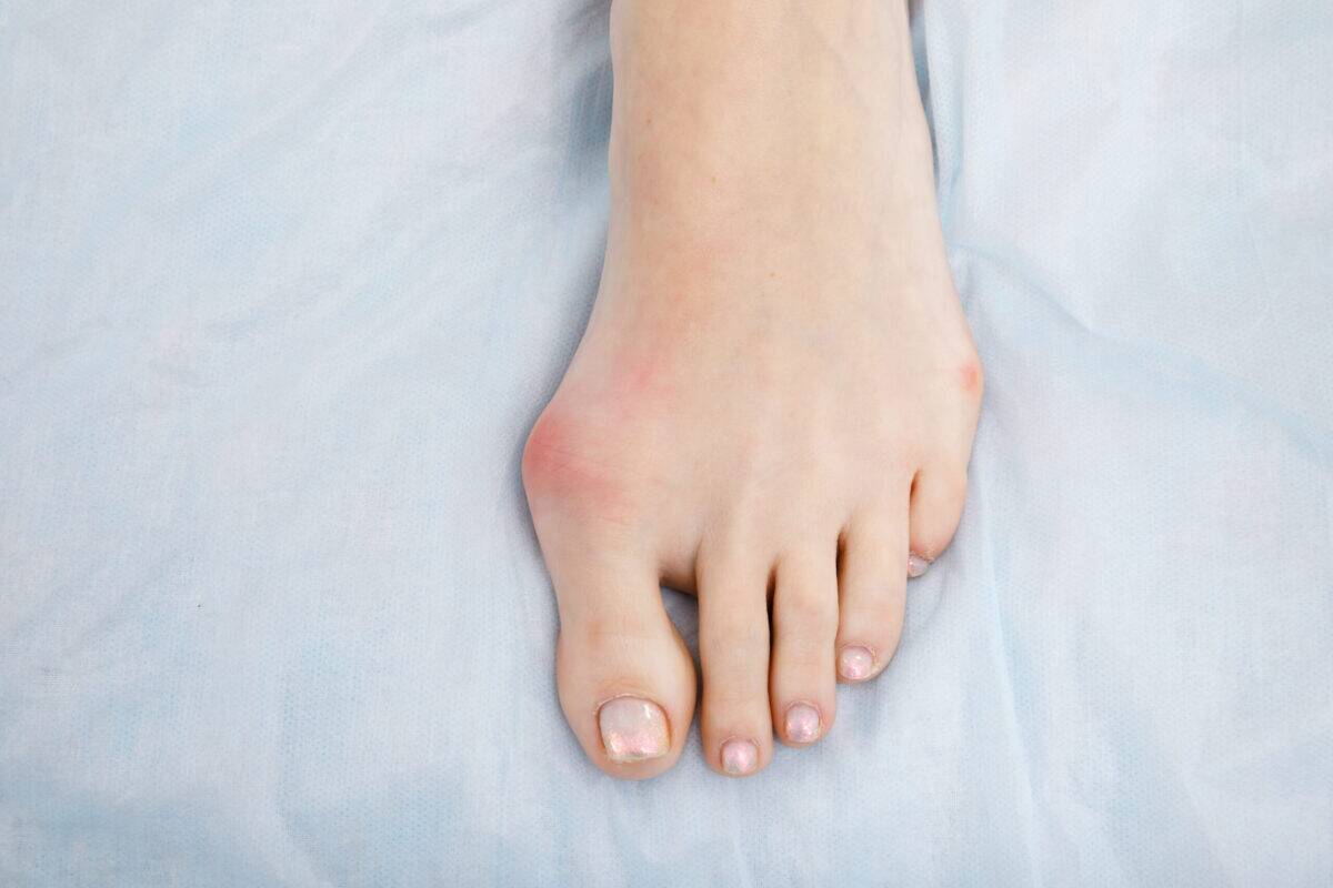 Causes & Treatment for an Outer Foot Bunion | Northwest Surgery Center