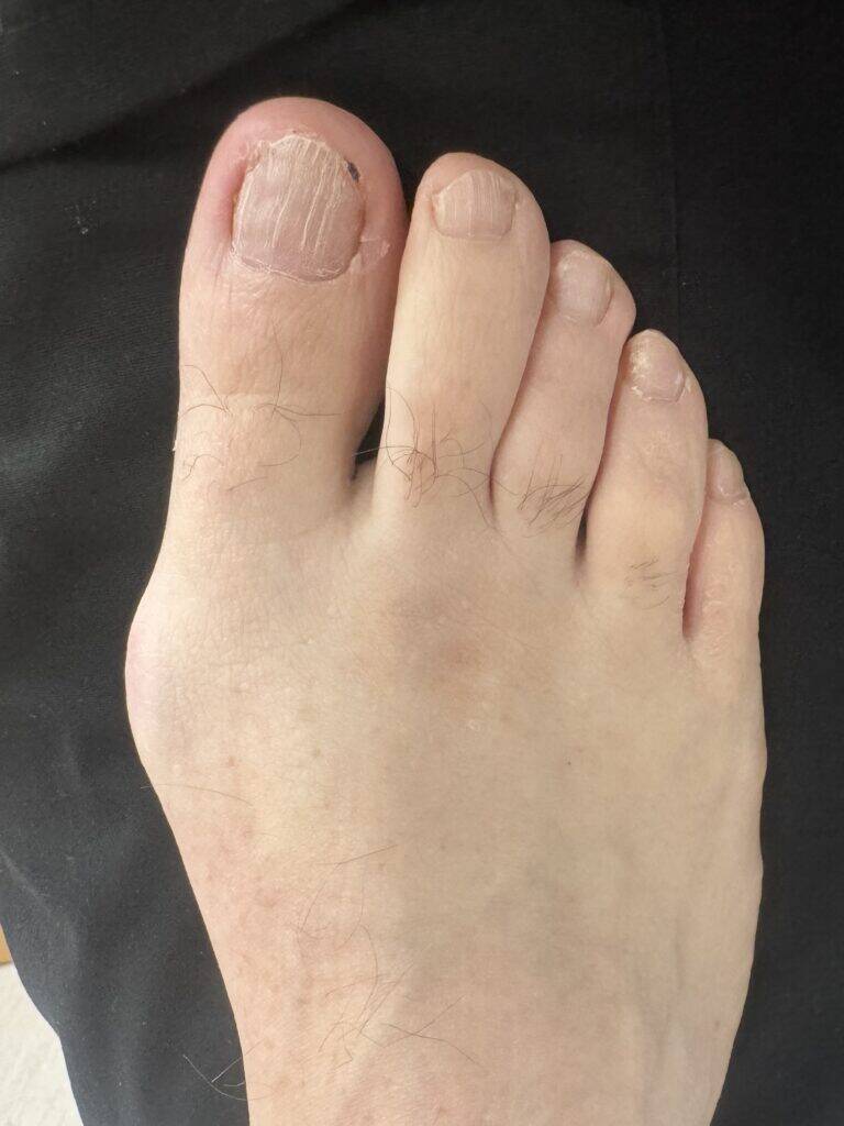 Bunion Surgery Before and After Photos | Northwest Surgery Center