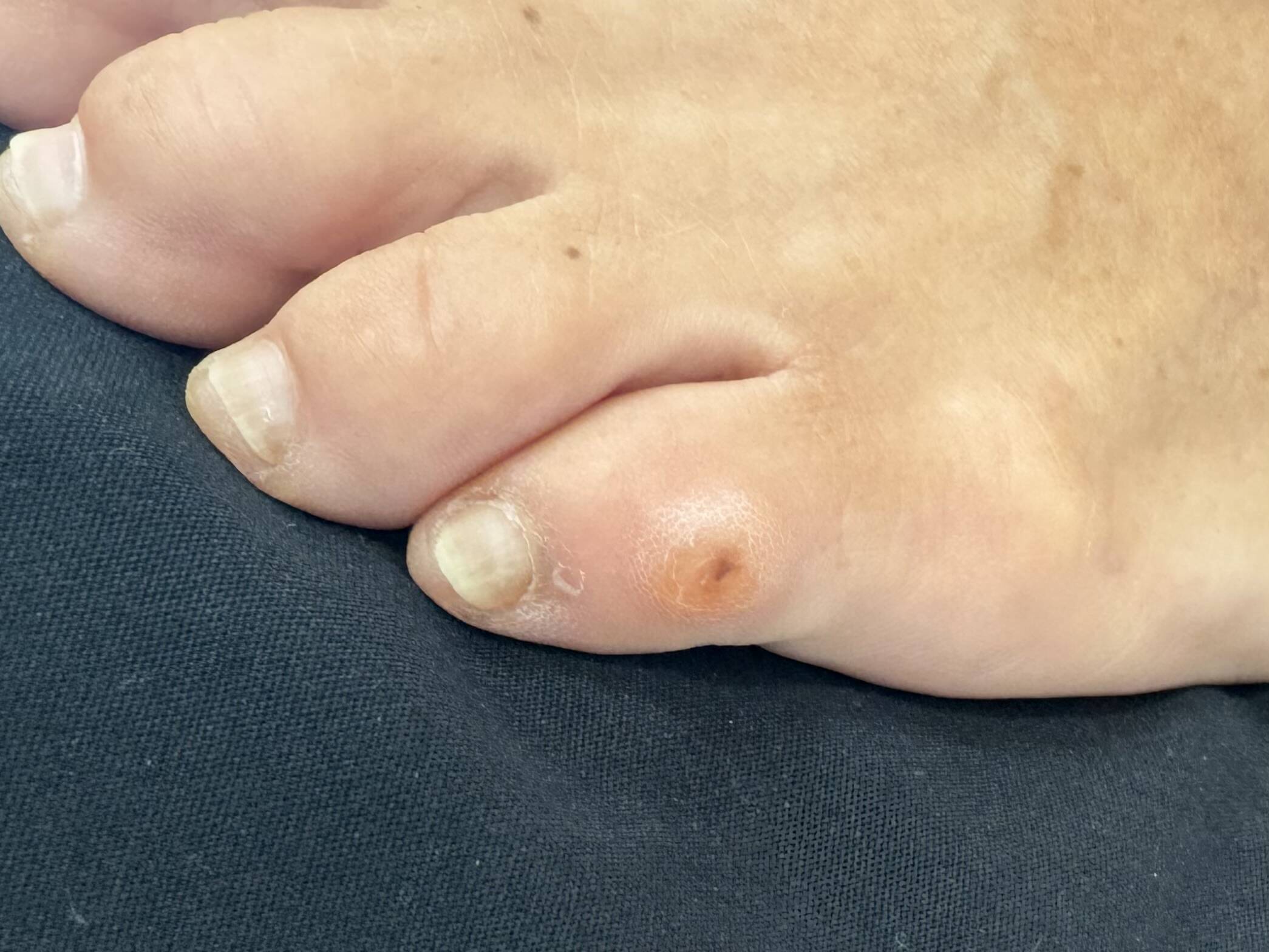 Corn and Callus Before and After Photos | Northwest Surgery Center