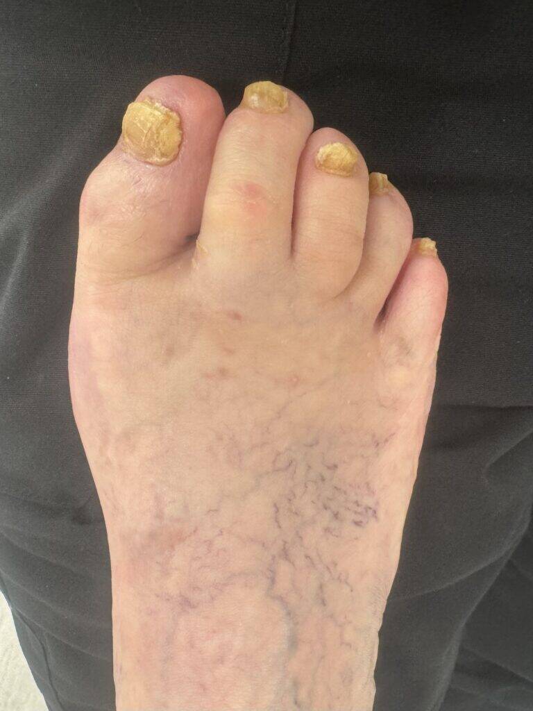 Bunion Before and After Photos | Northwest Surgery Center