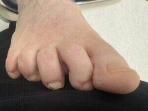 Hammertoe Before and After Photos | Northwest Surgery Center