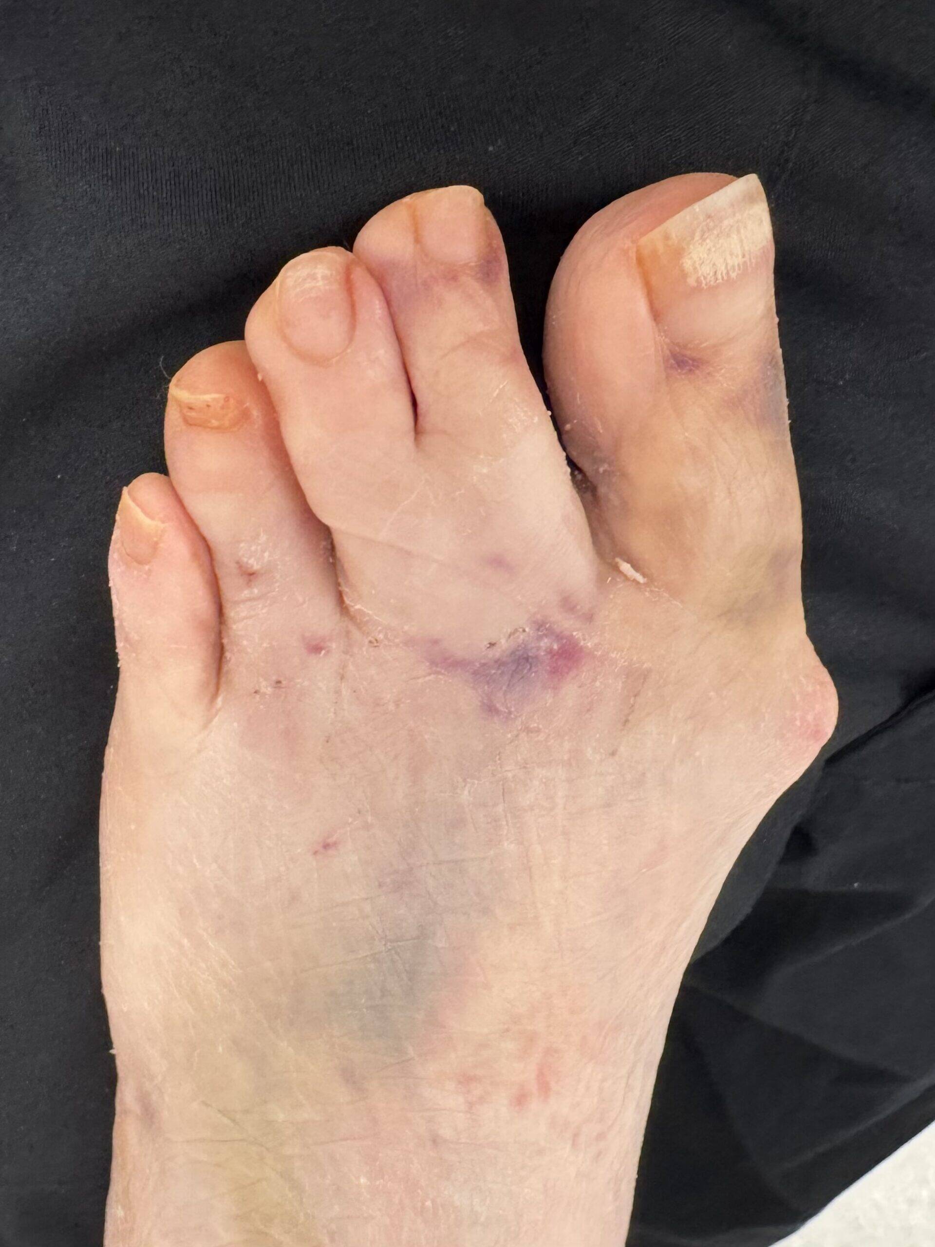 Hammertoe Before and After Photos | Northwest Surgery Center