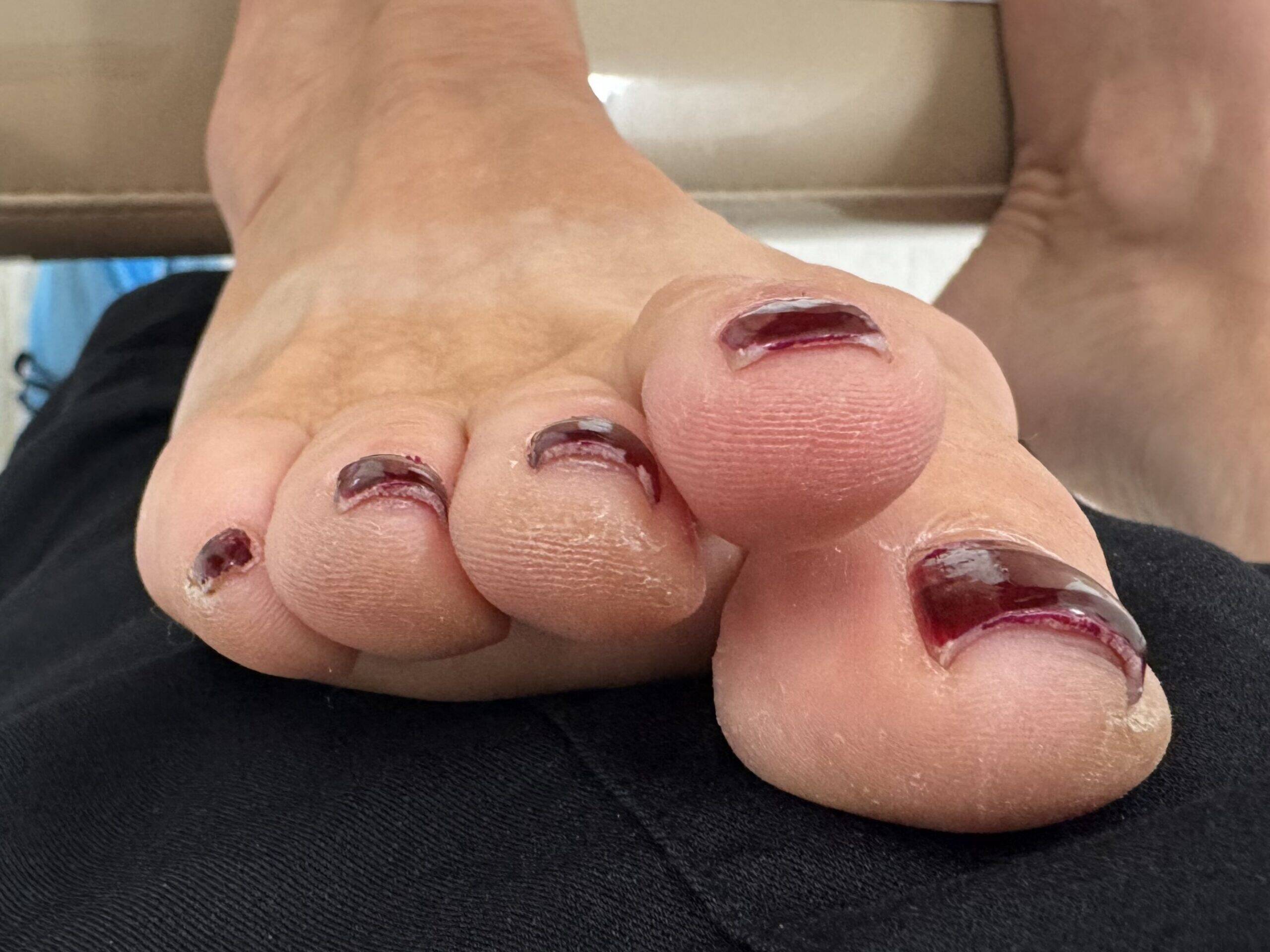 Hammertoe Before and After Photos | Northwest Surgery Center