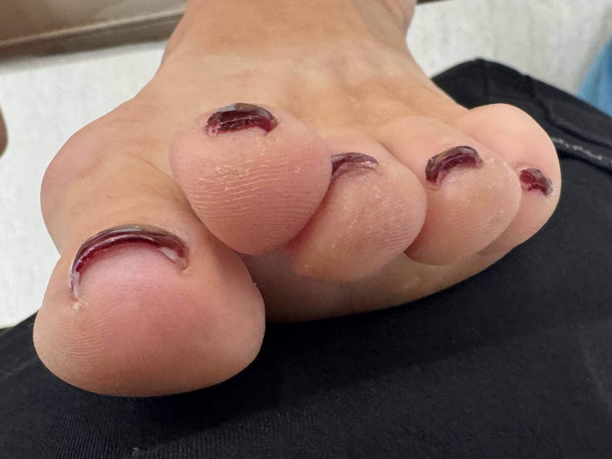 Hammertoe Before and After Photos | Northwest Surgery Center
