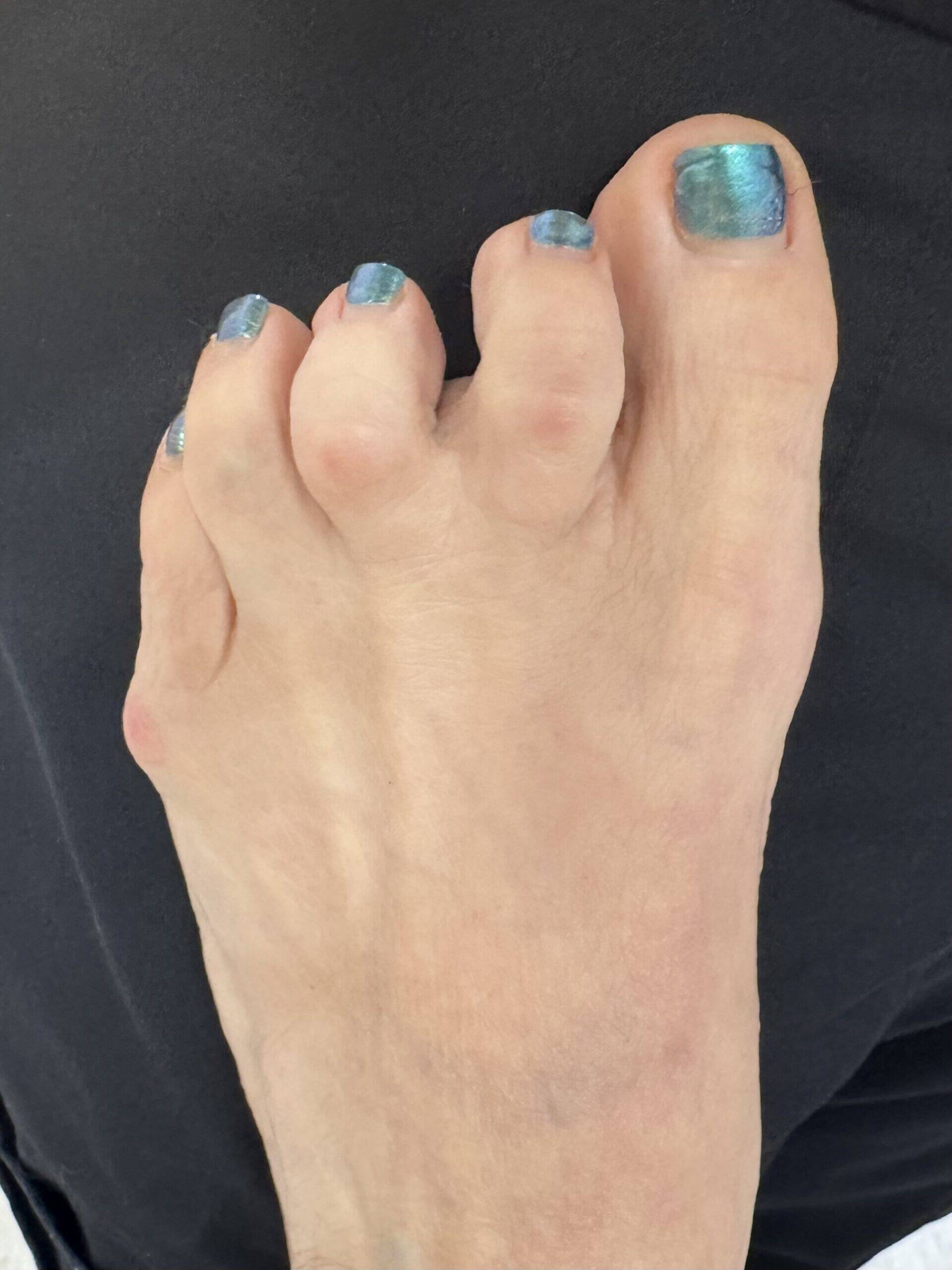 Hammertoe Before and After Photos | Northwest Surgery Center