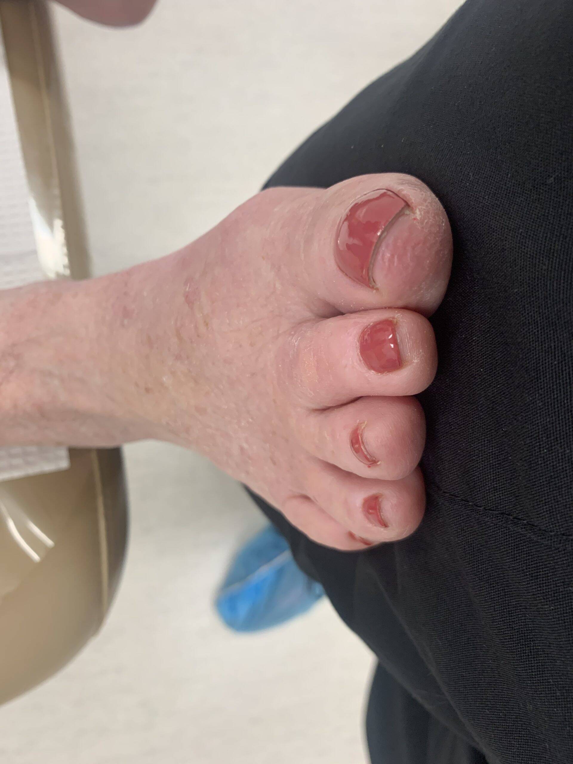 Hammertoe Before and After Photos | Northwest Surgery Center