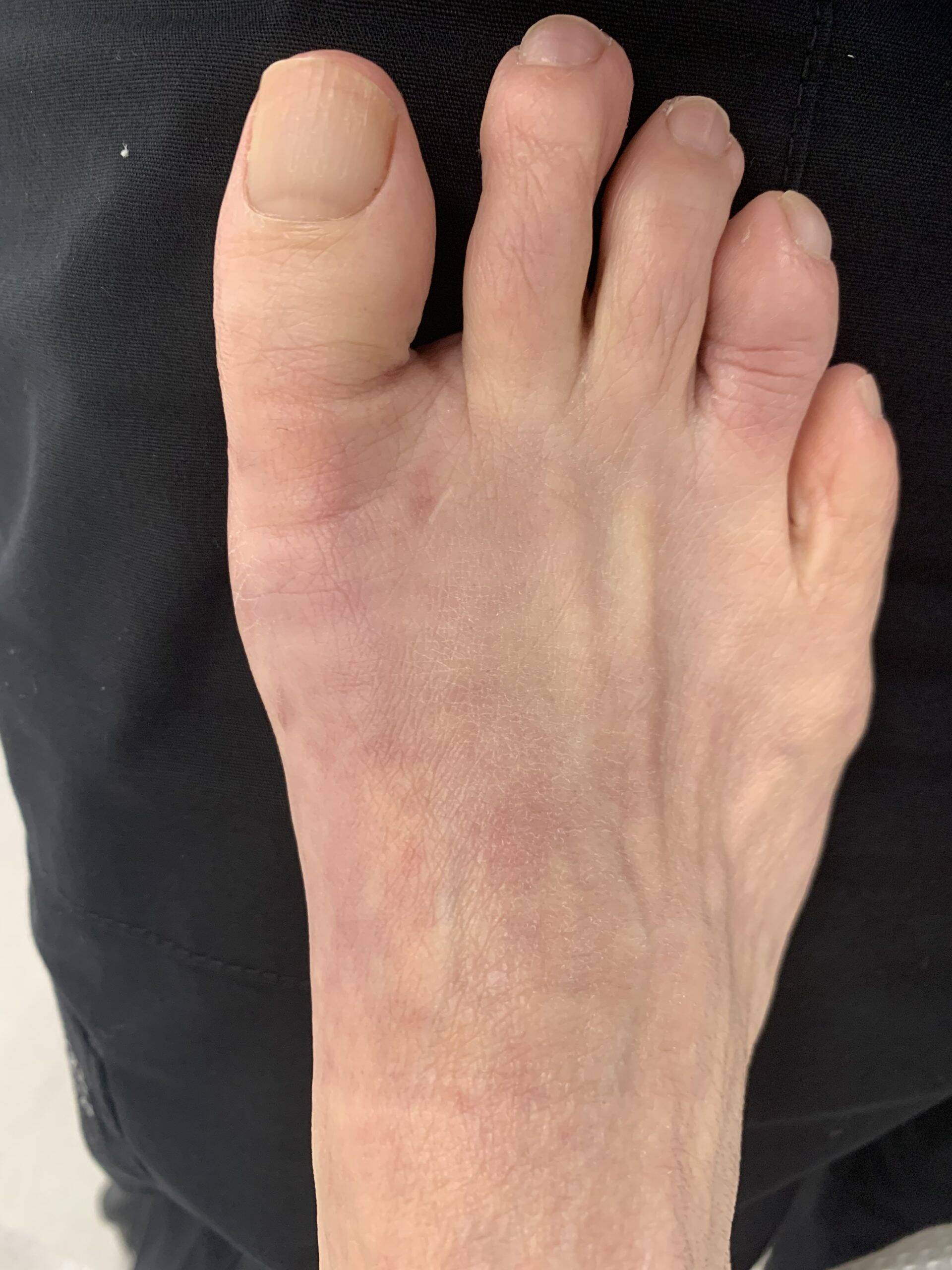 Bunion Surgery Before and After Photos | Northwest Surgery Center