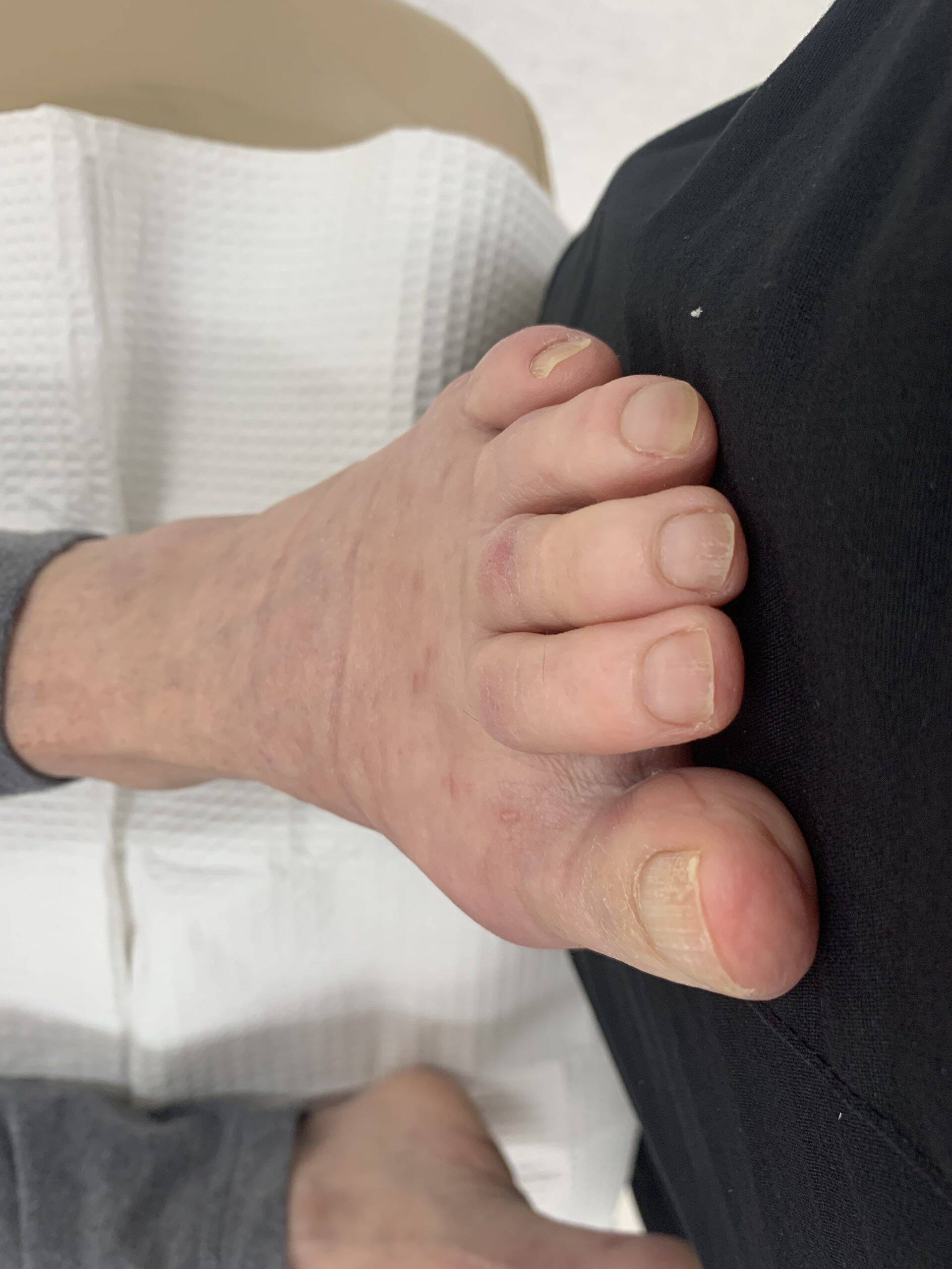 Bunion Surgery Before and After Photos | Northwest Surgery Center
