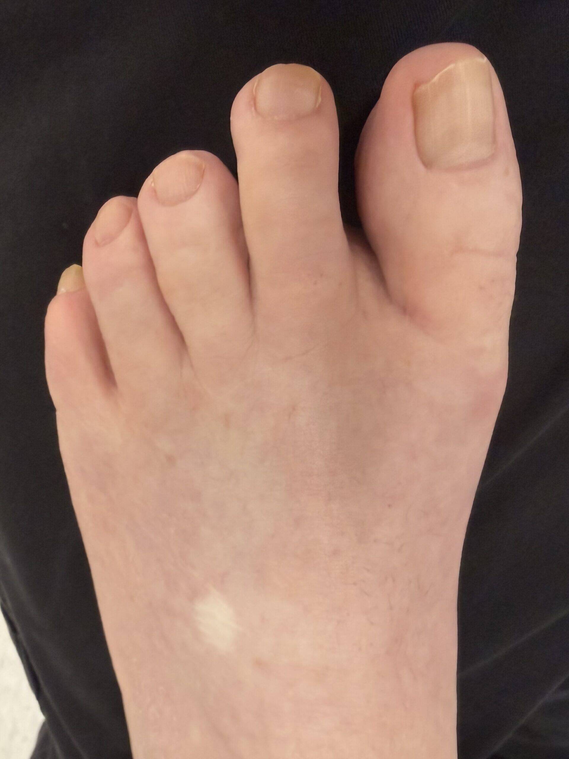 Hammertoe Before and After Photos | Northwest Surgery Center