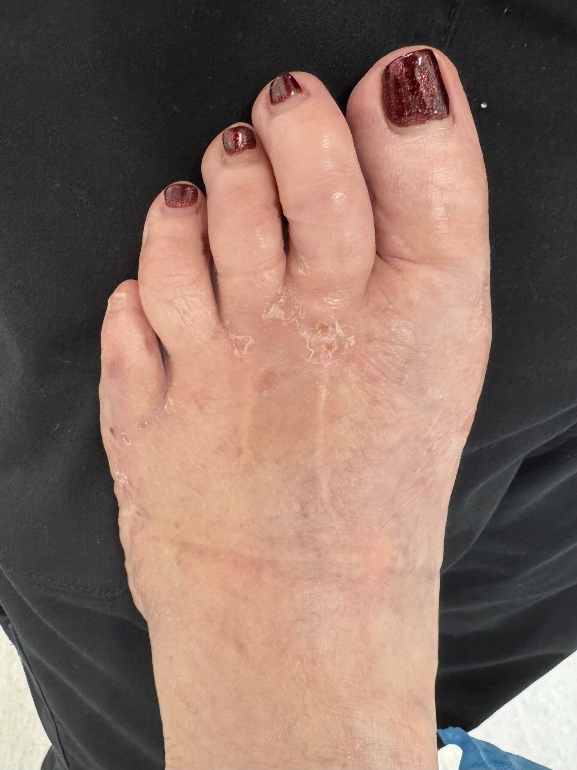Hammertoe Before and After Photos | Northwest Surgery Center