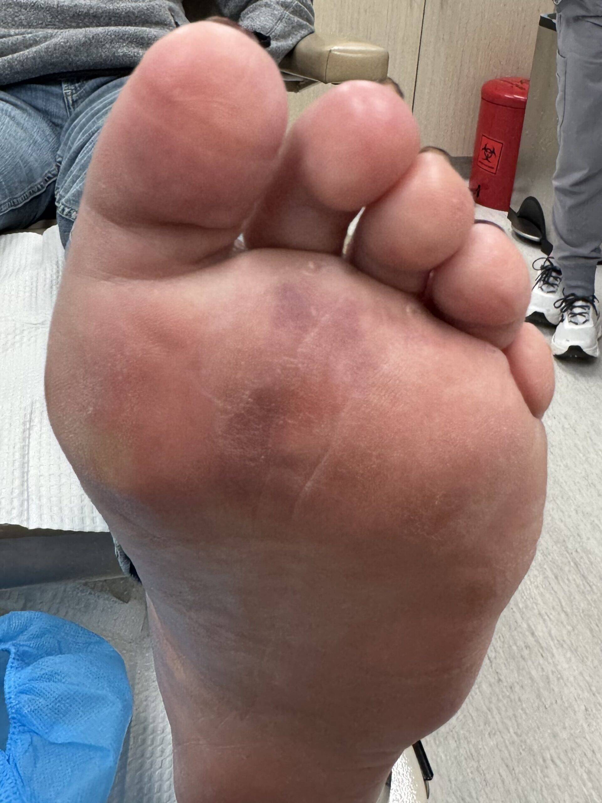 Hammertoe Before and After Photos | Northwest Surgery Center