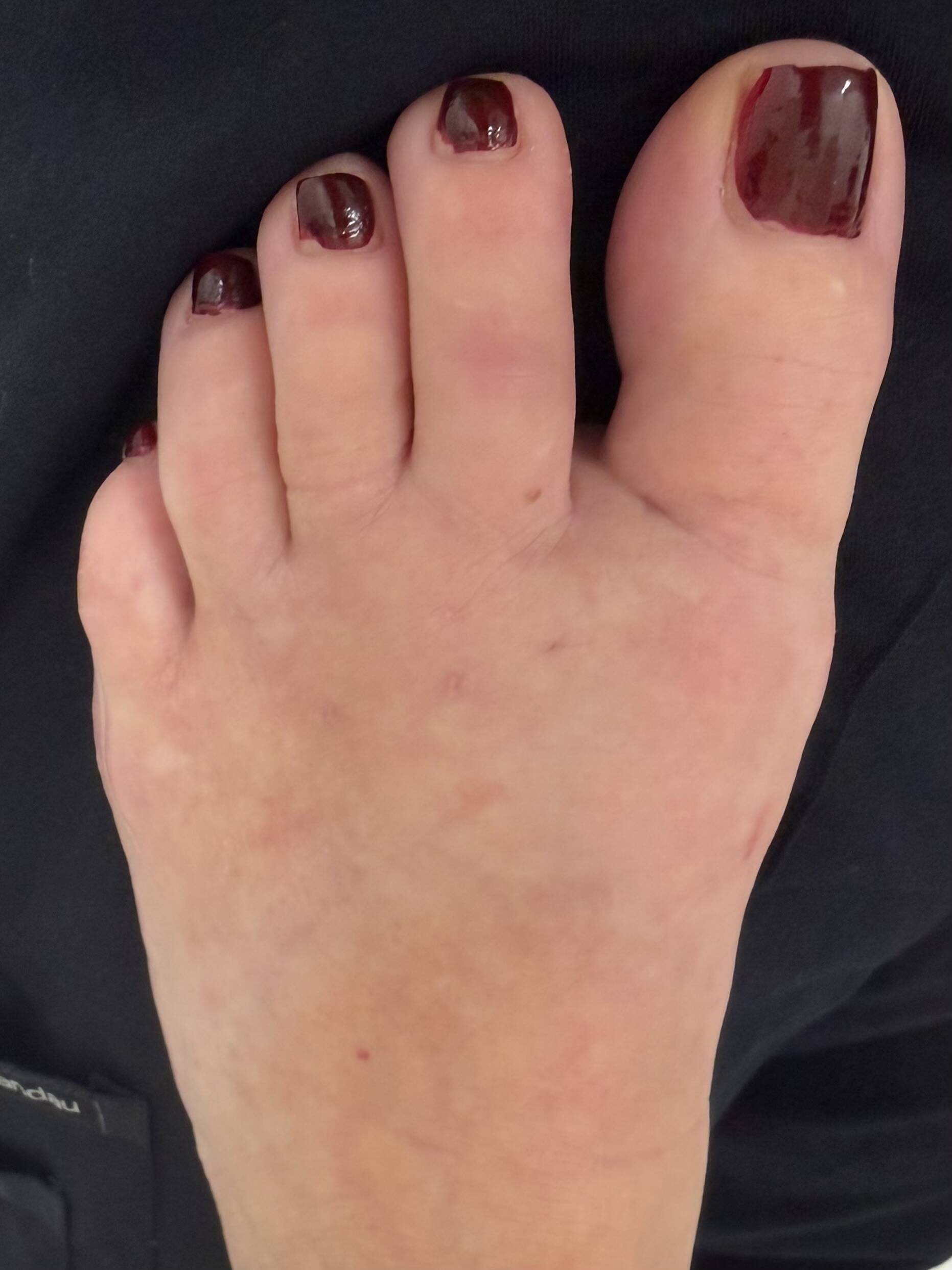 Hammertoe Before and After Photos | Northwest Surgery Center
