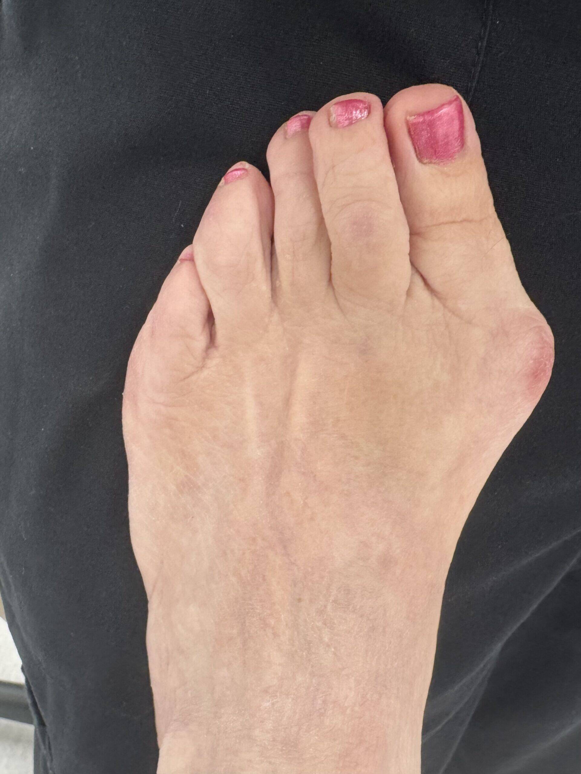 Severe Bunion Before and After Photos | Northwest Surgery Center