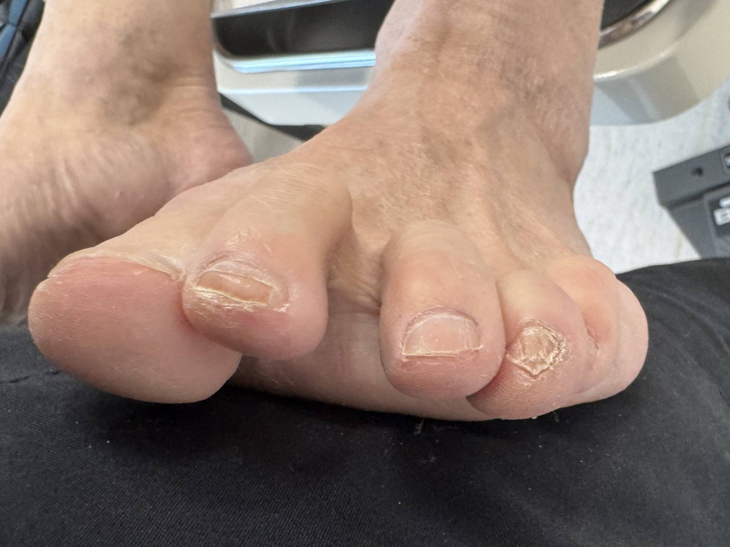 Hammertoe Before and After Photos | Northwest Surgery Center