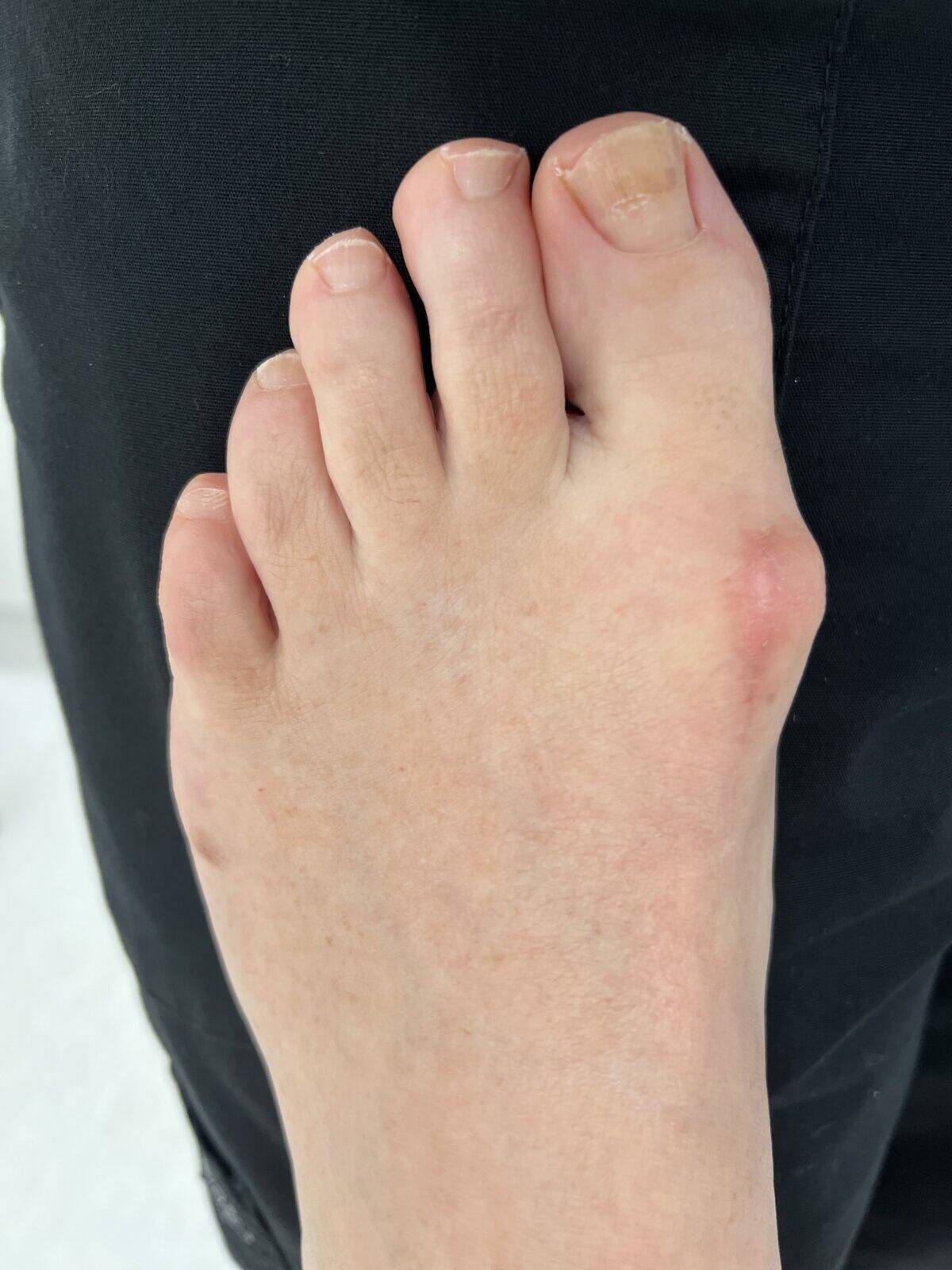 Hallux Rigidus vs Bunion: How to Tell the Difference