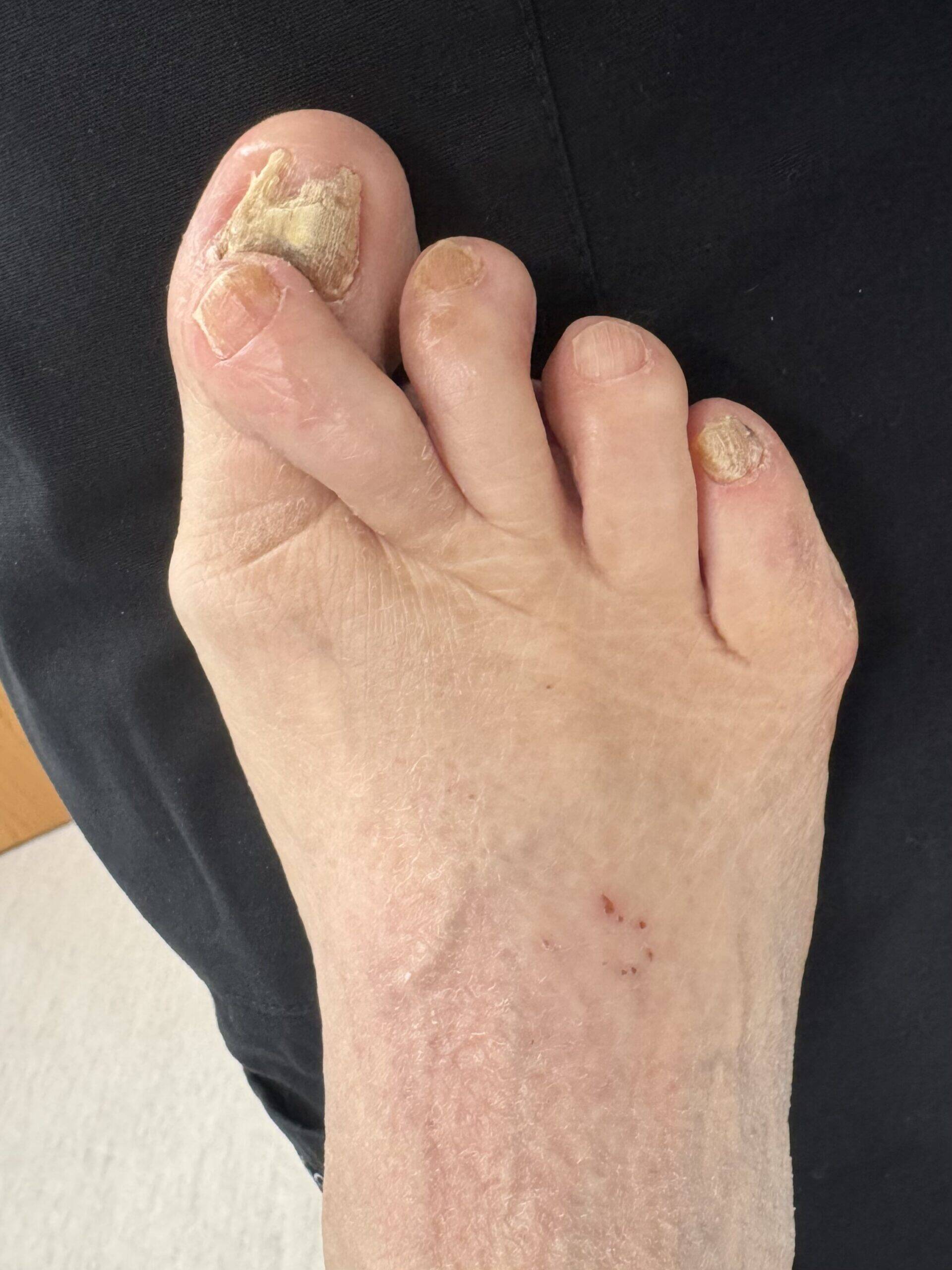 Hammertoe Before and After Photos | Northwest Surgery Center