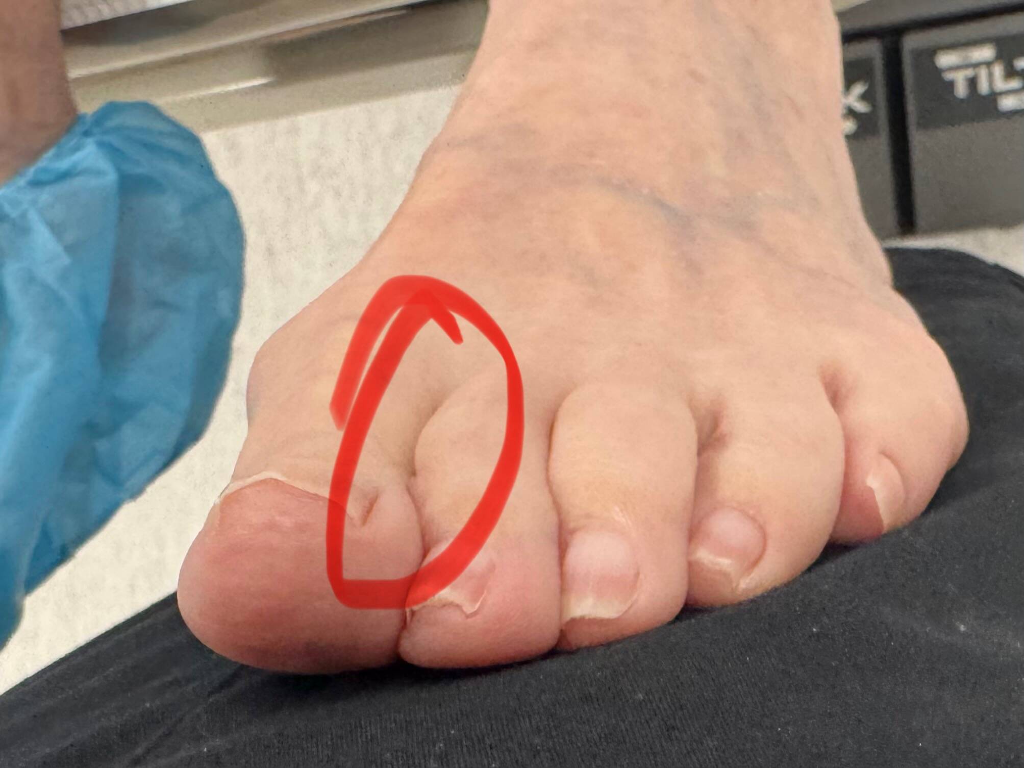 Hammertoe Before and After Photos | Northwest Surgery Center