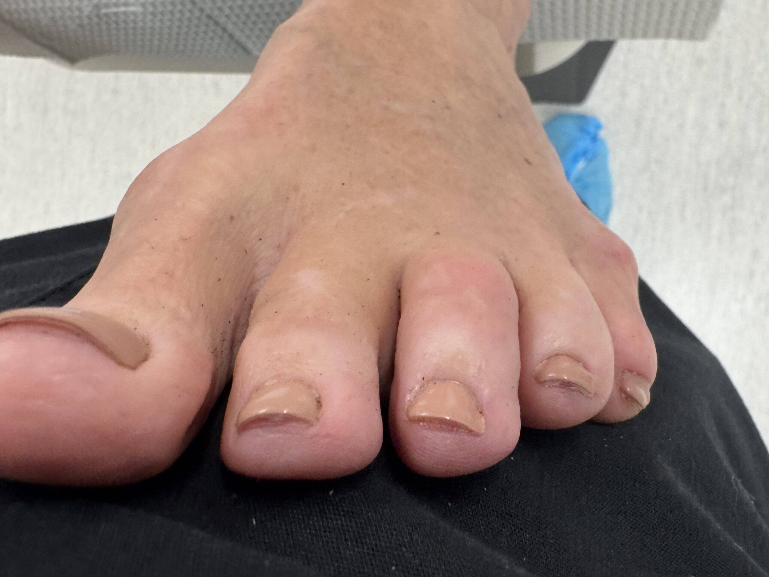 Hammertoe Before and After Photos | Northwest Surgery Center