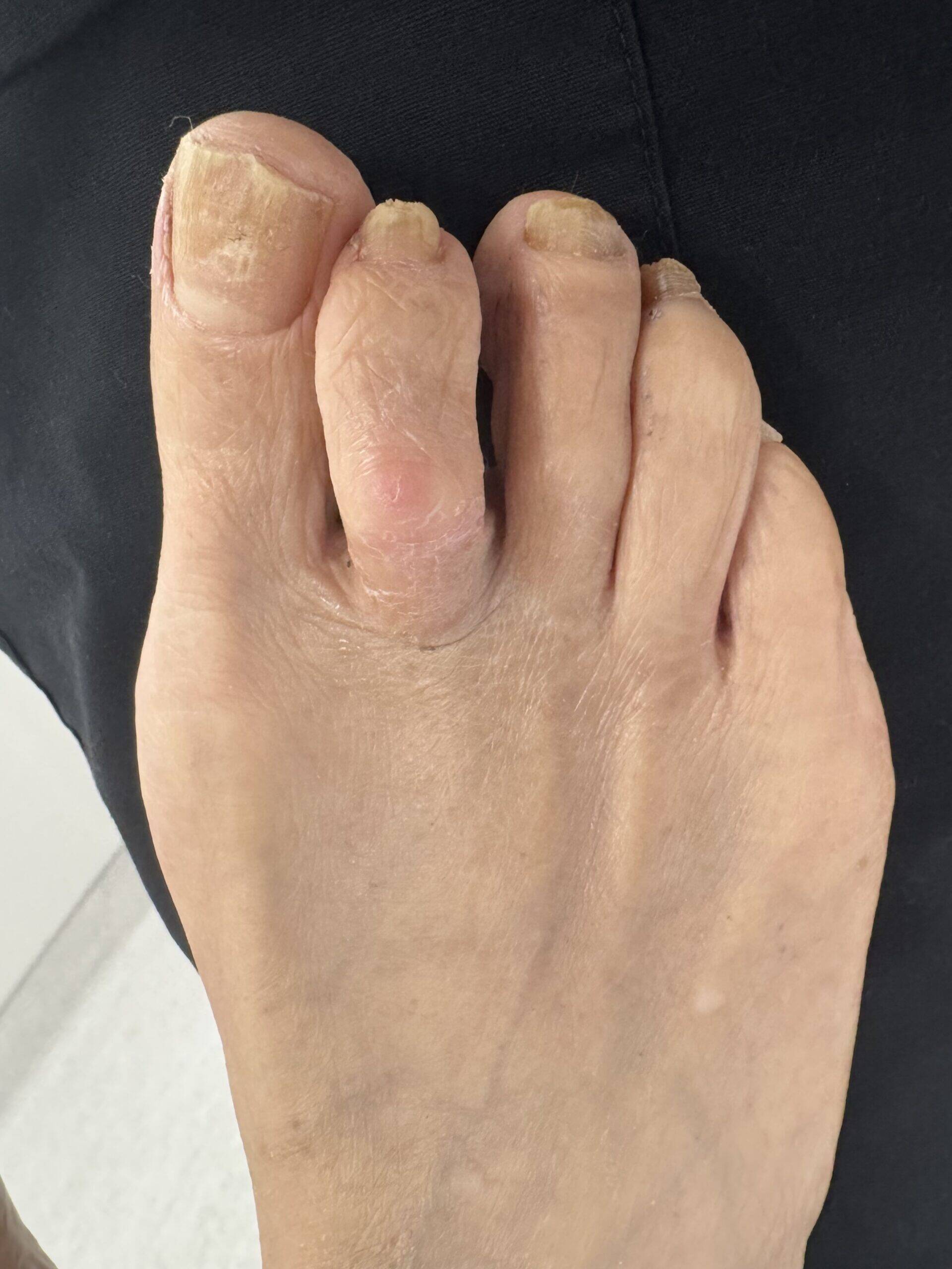 Hammertoe Before and After Photos | Northwest Surgery Center