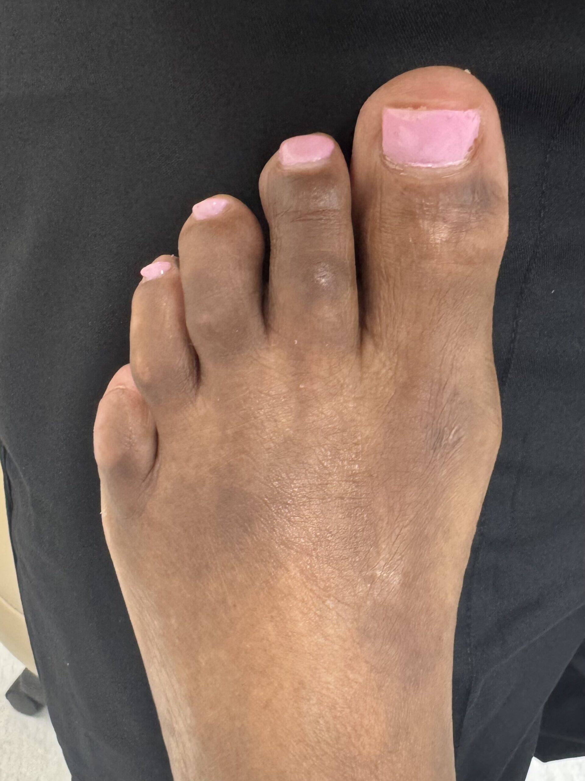 Hammertoe Before and After Photos | Northwest Surgery Center