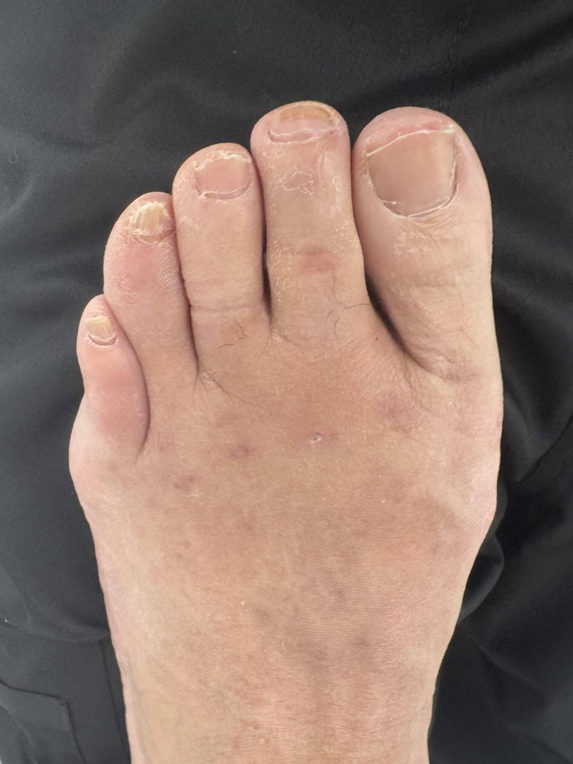 Hammertoe Before and After Photos | Northwest Surgery Center
