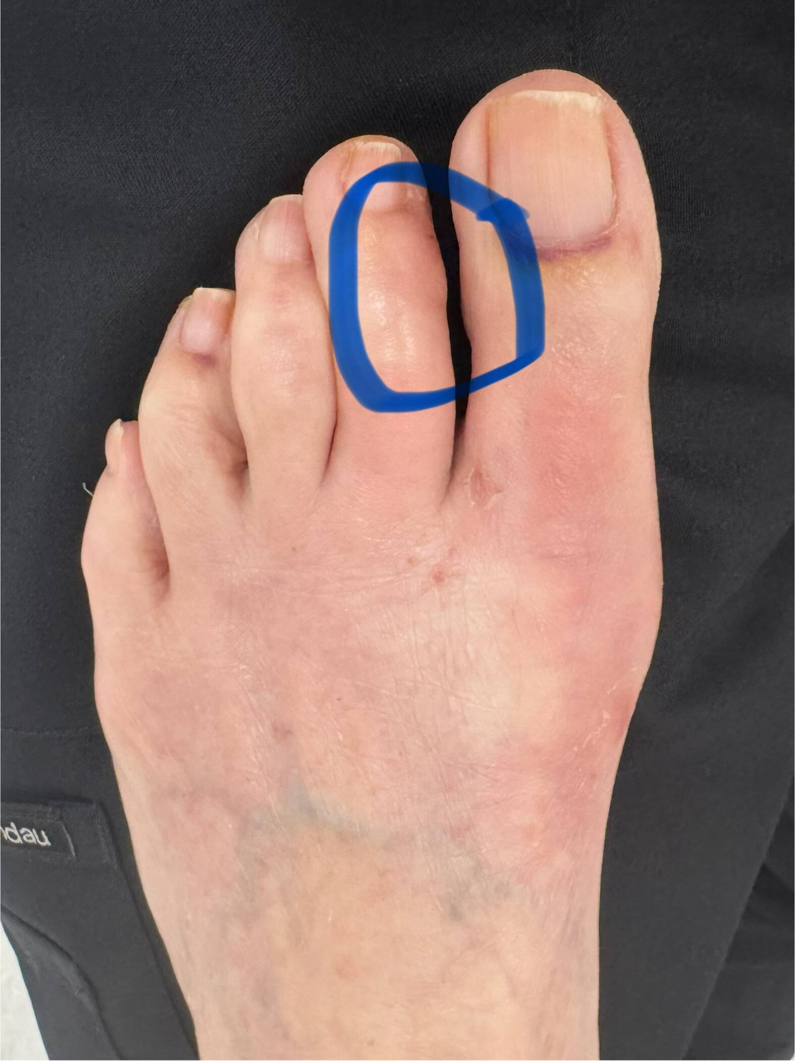 Hammertoe Before and After Photos | Northwest Surgery Center