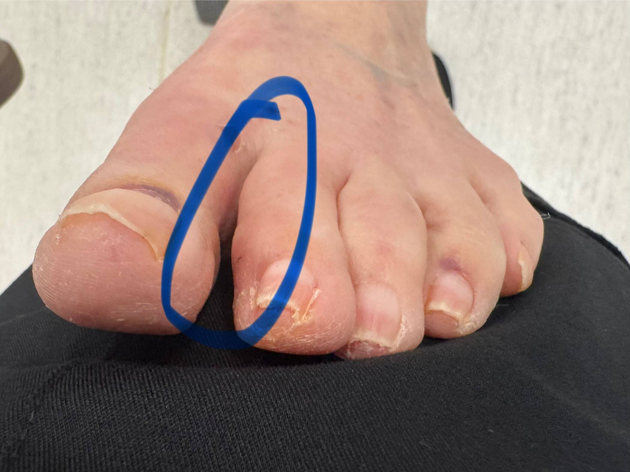 Hammertoe Before and After Photos | Northwest Surgery Center