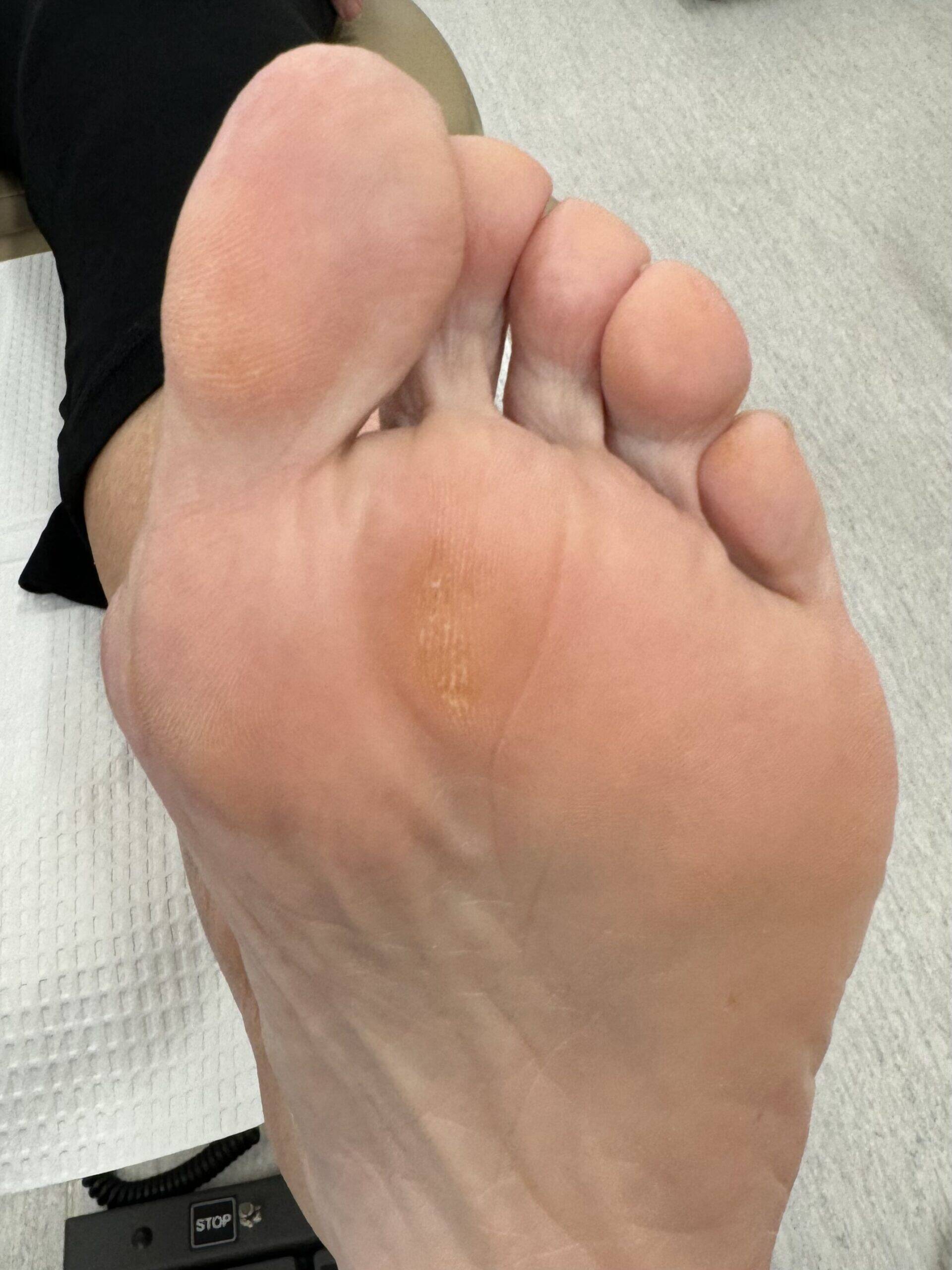 Corn and Callus Before and After Photos | Northwest Surgery Center