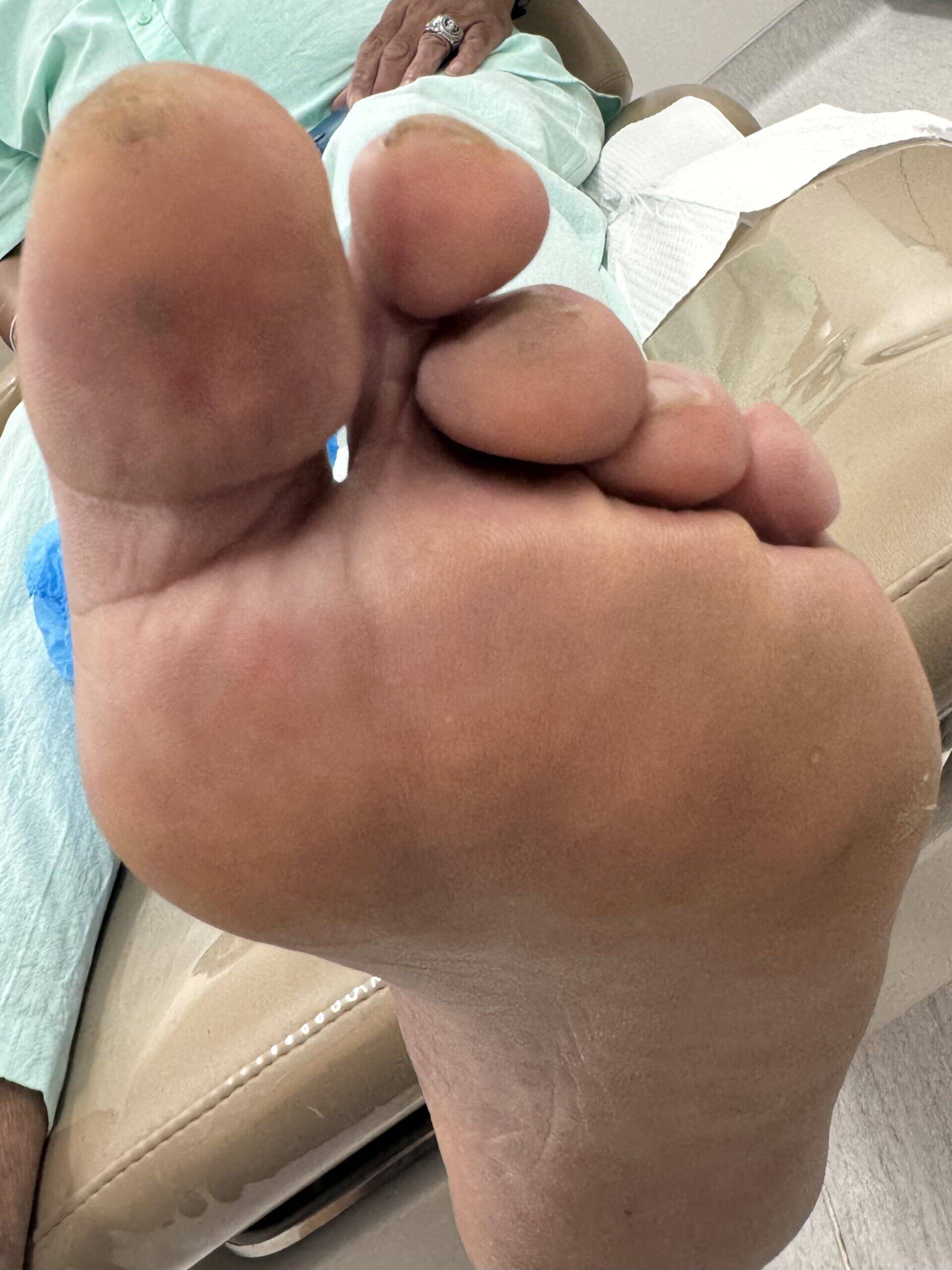 Hammertoe Before and After Photos | Northwest Surgery Center
