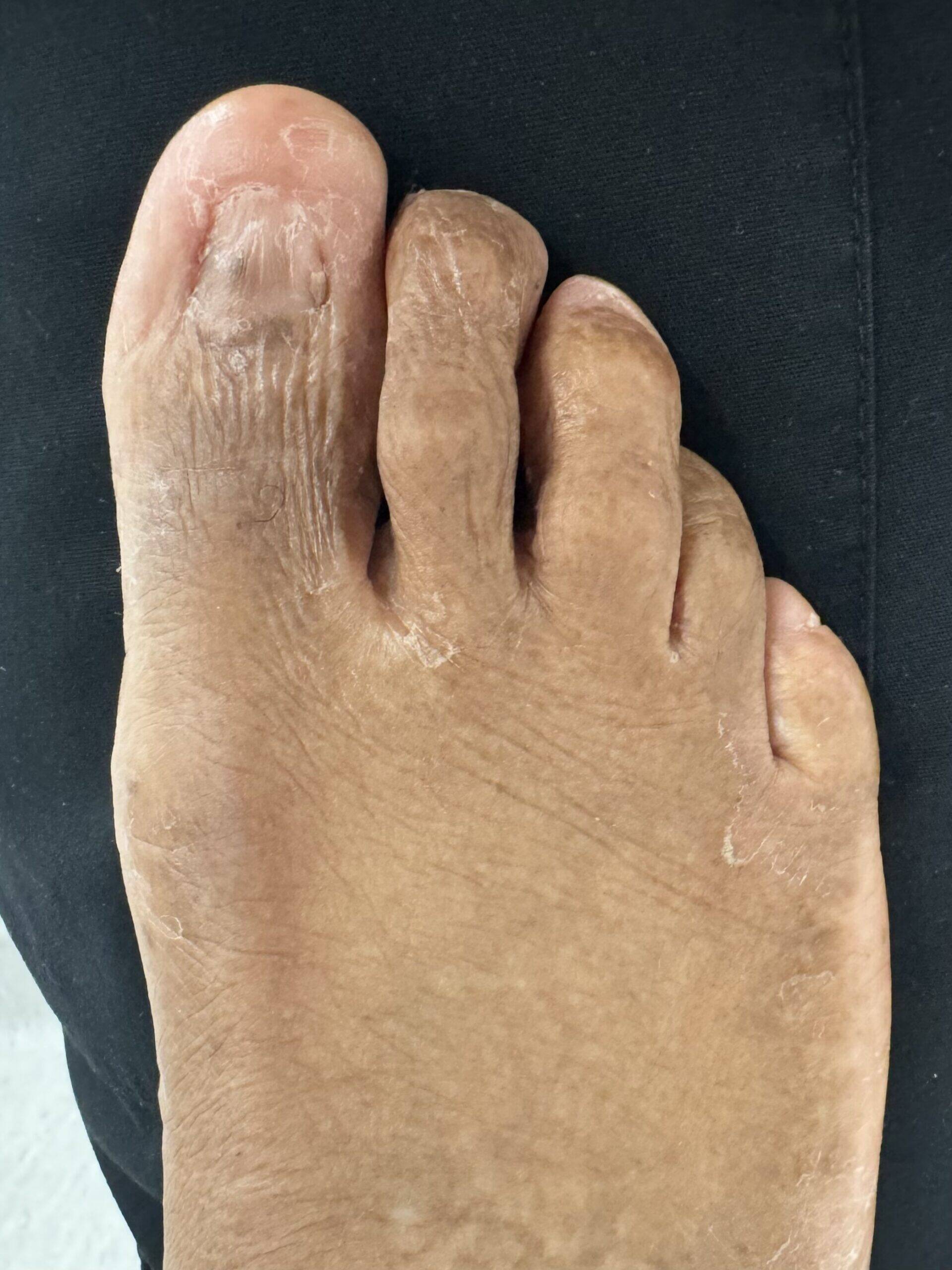 Hammertoe Before and After Photos | Northwest Surgery Center