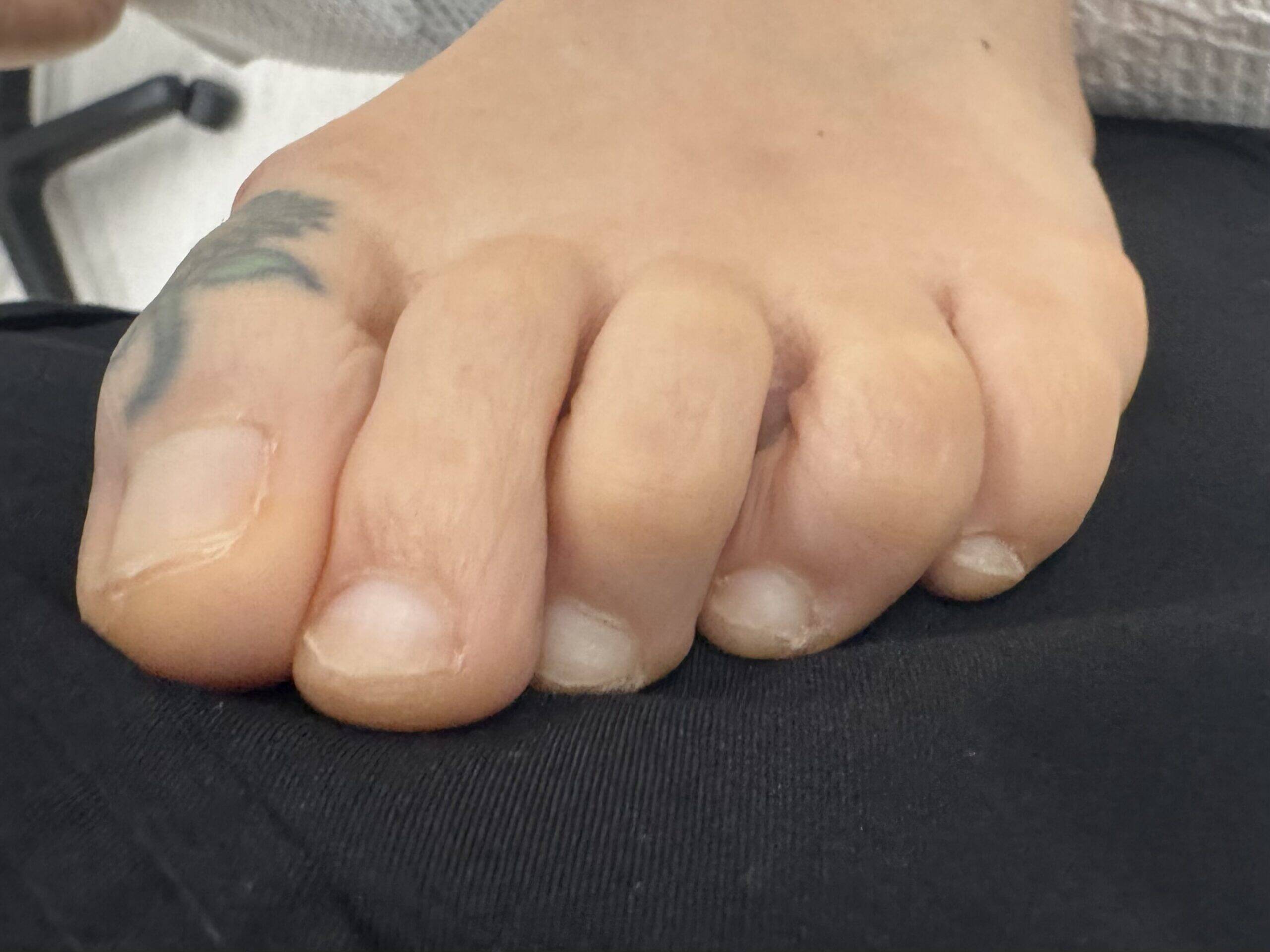 Mallet Toe Before and After Photos | Northwest Surgery Center