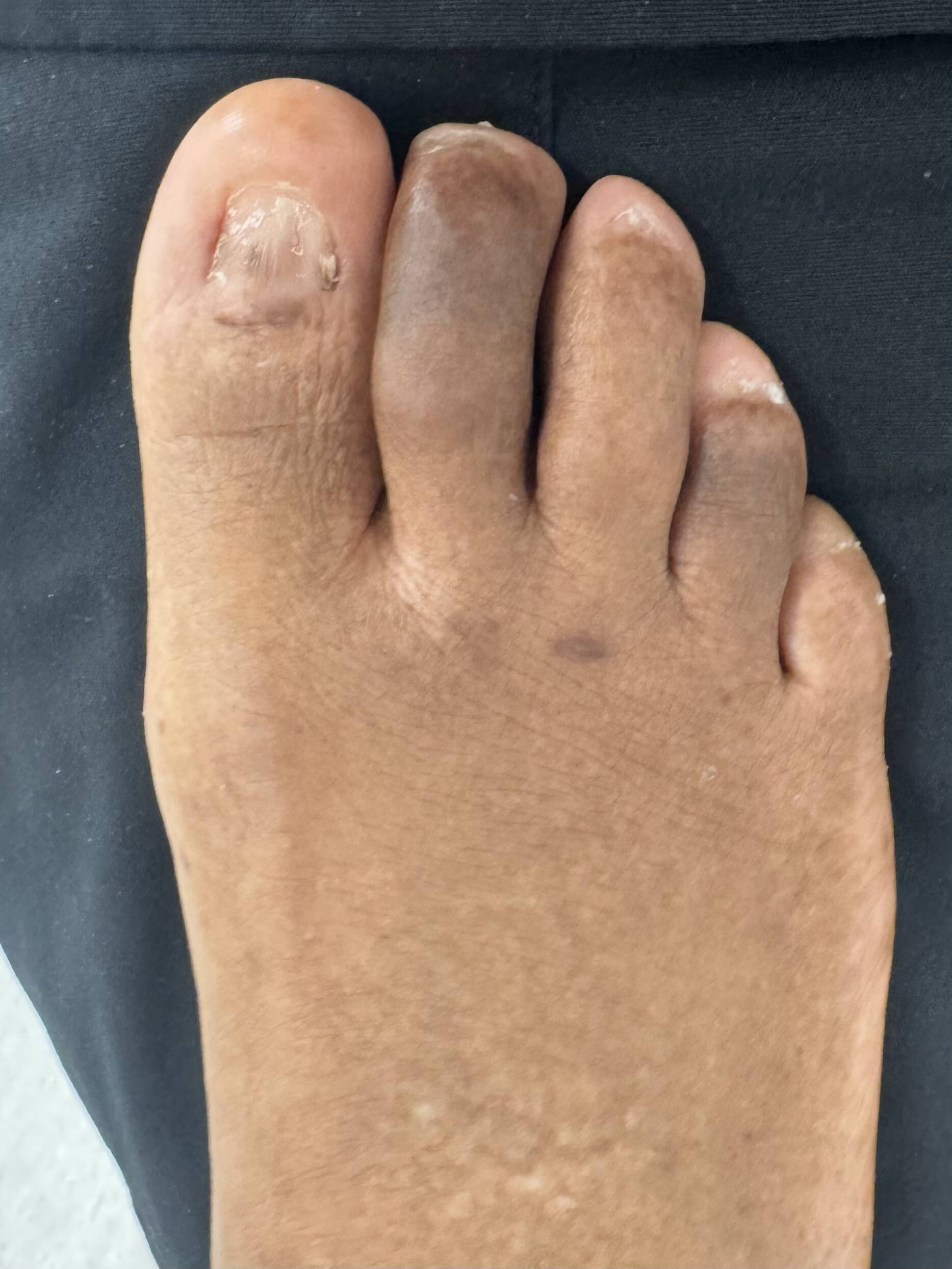 Hammertoe Before and After Photos | Northwest Surgery Center