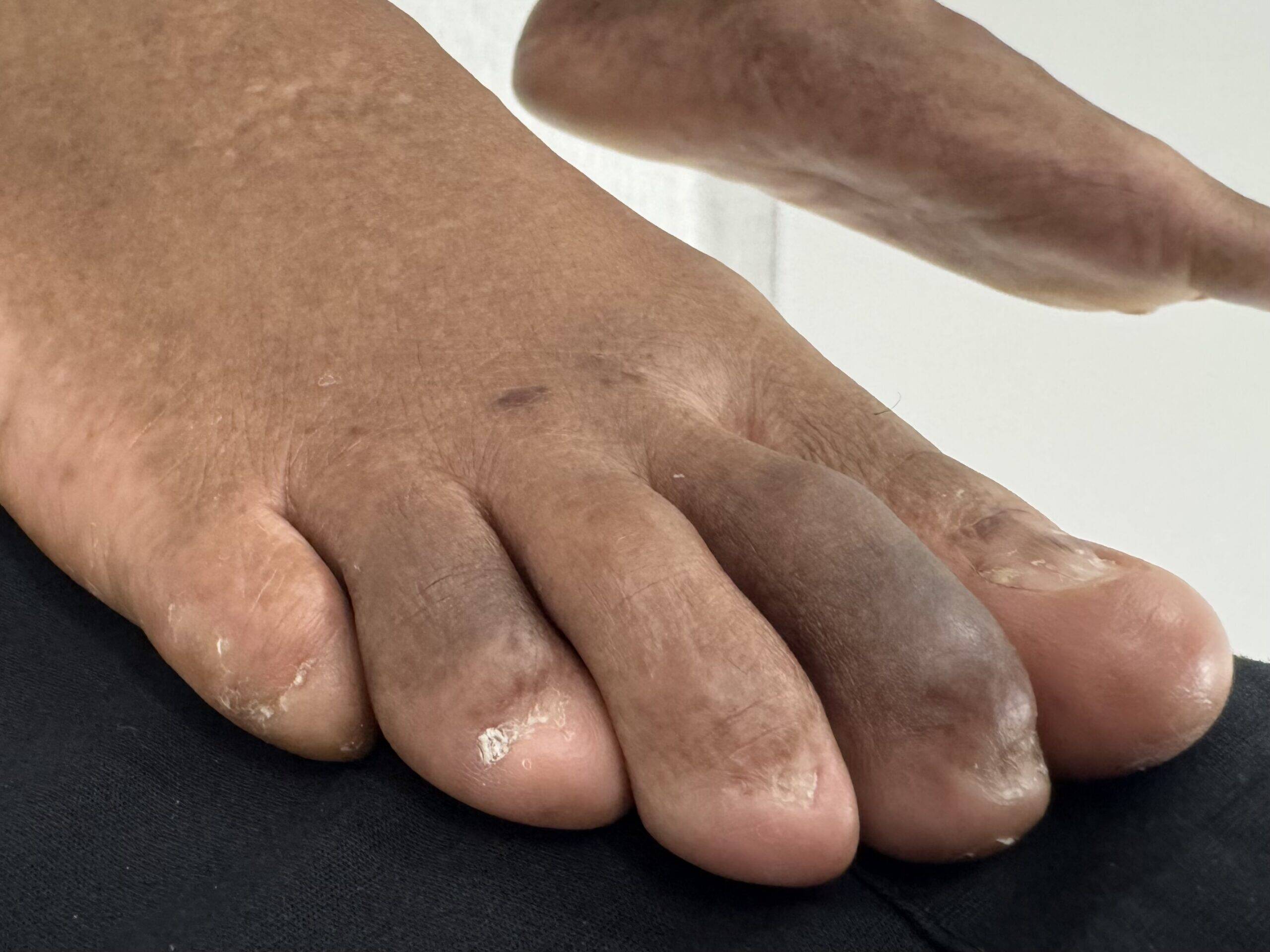 Hammertoe Before and After Photos | Northwest Surgery Center