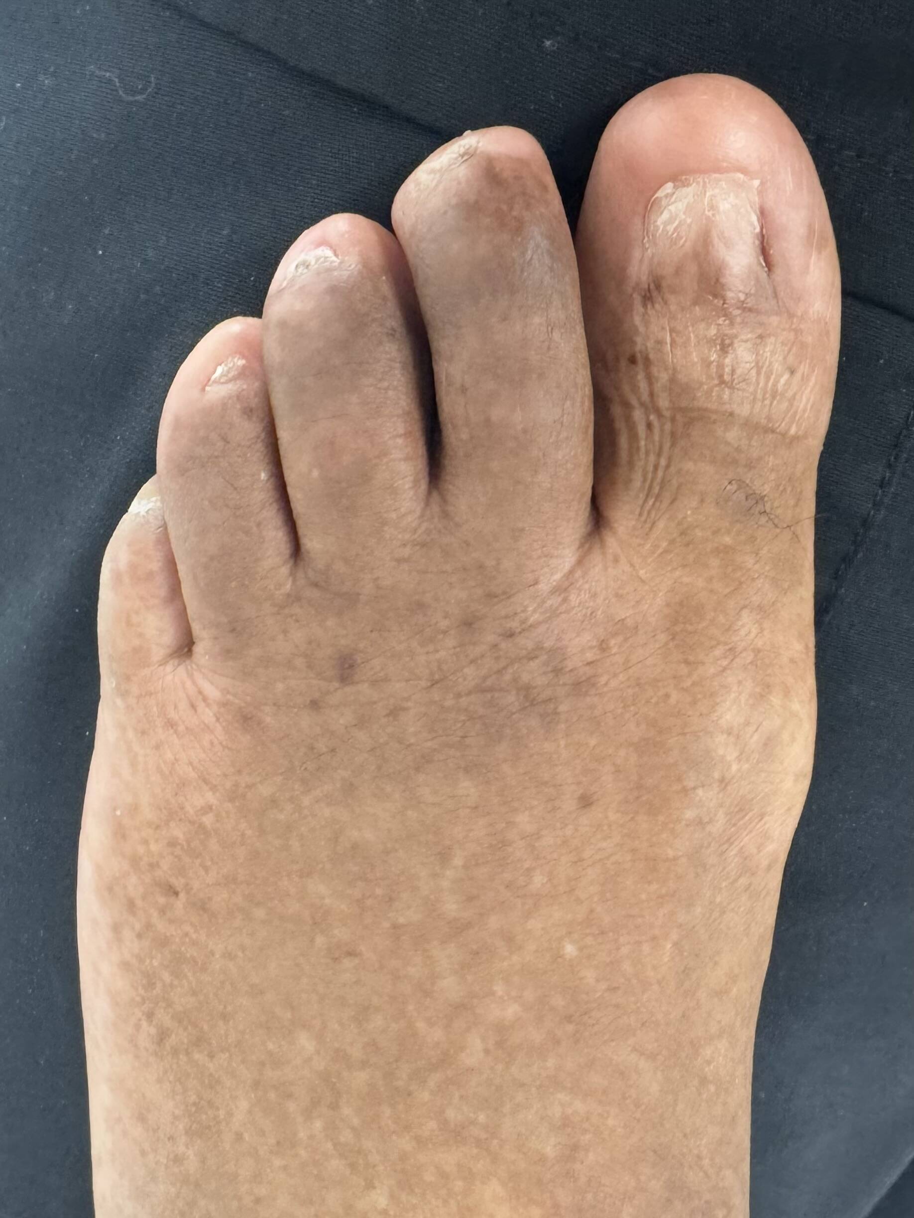 Hammertoe Before and After Photos | Northwest Surgery Center